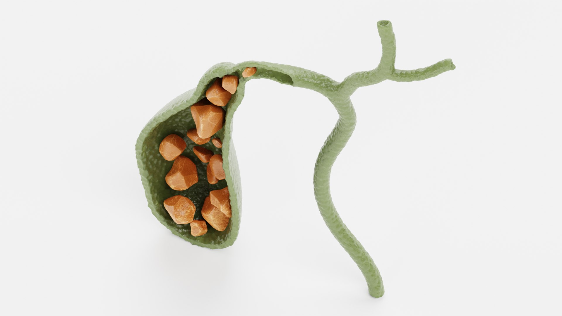 Gallbladder with Gallstones model - TurboSquid 1756732
