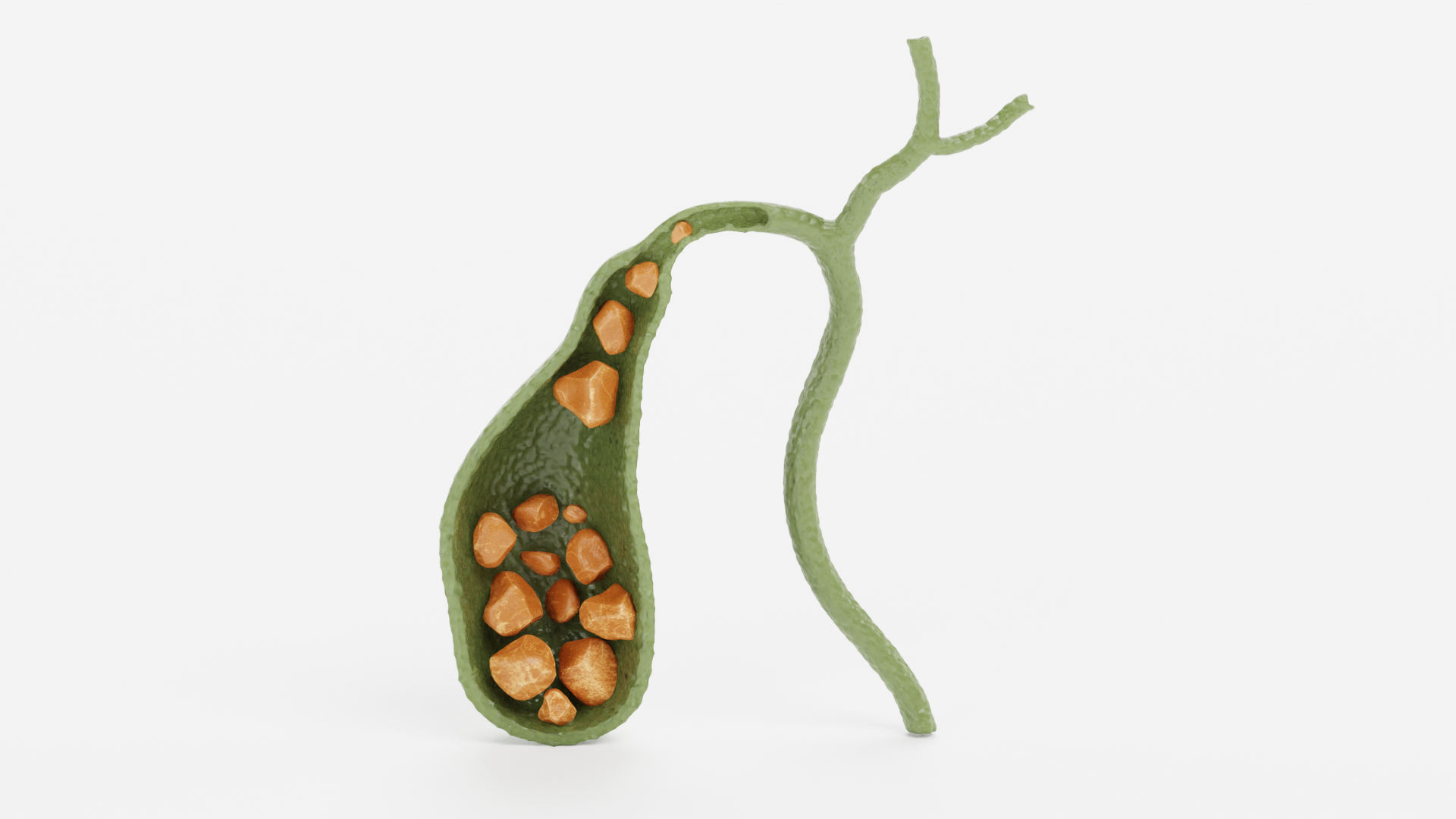 Gallbladder with Gallstones model - TurboSquid 1756732