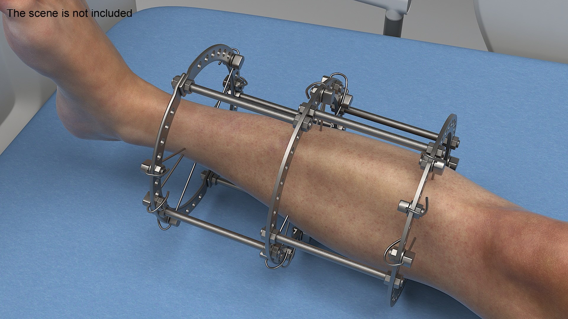 3D Ilizarov Apparatus On Leg - TurboSquid 2412793