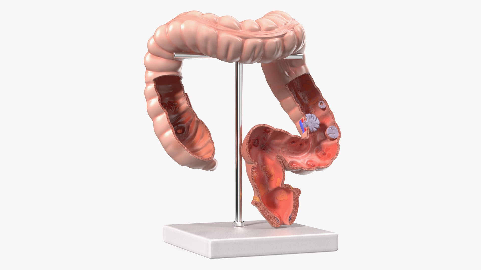 Medical Model Diseased Intestine Model - TurboSquid 2068464