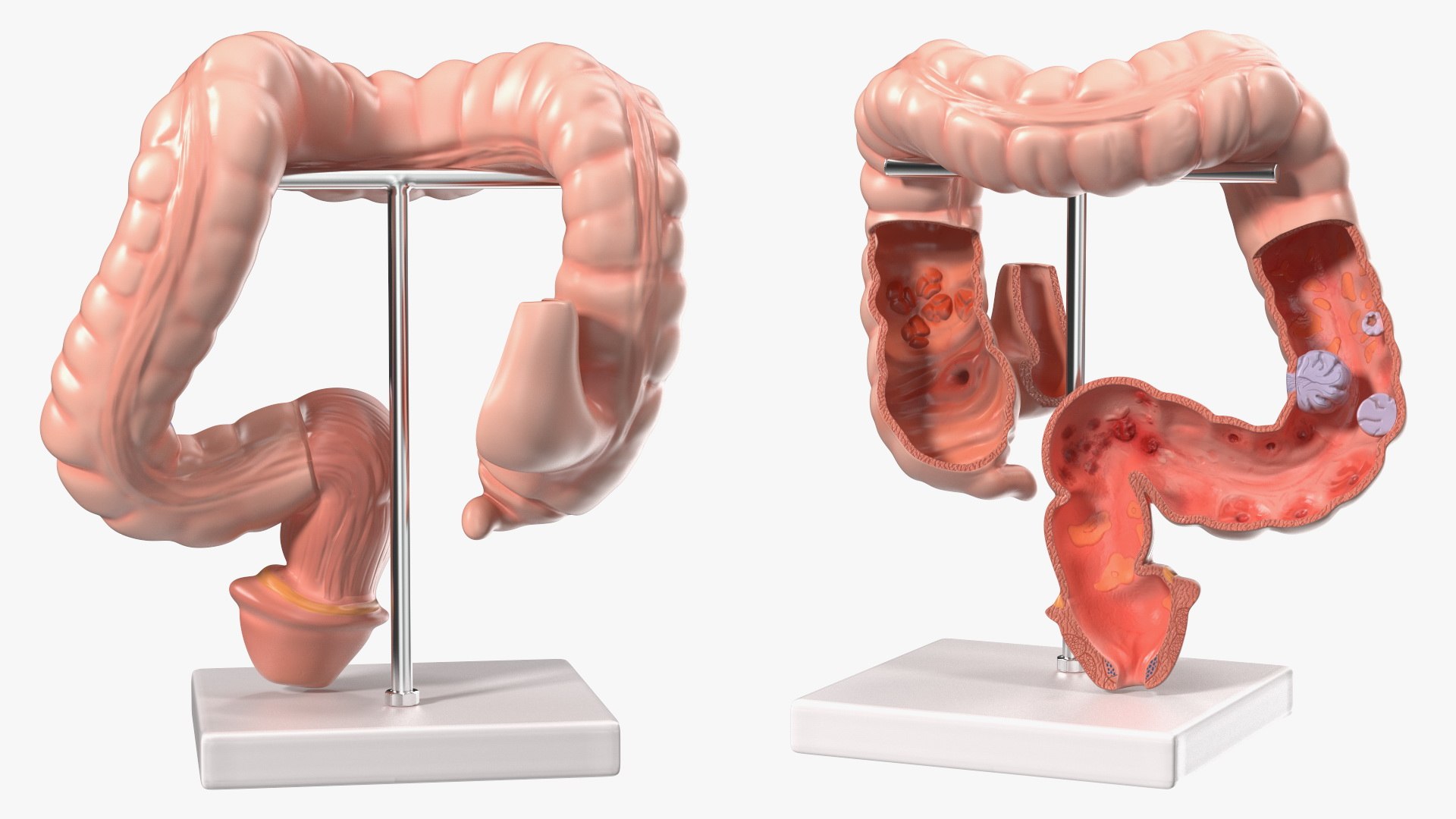 Medical Model Diseased Intestine Model - TurboSquid 2068464