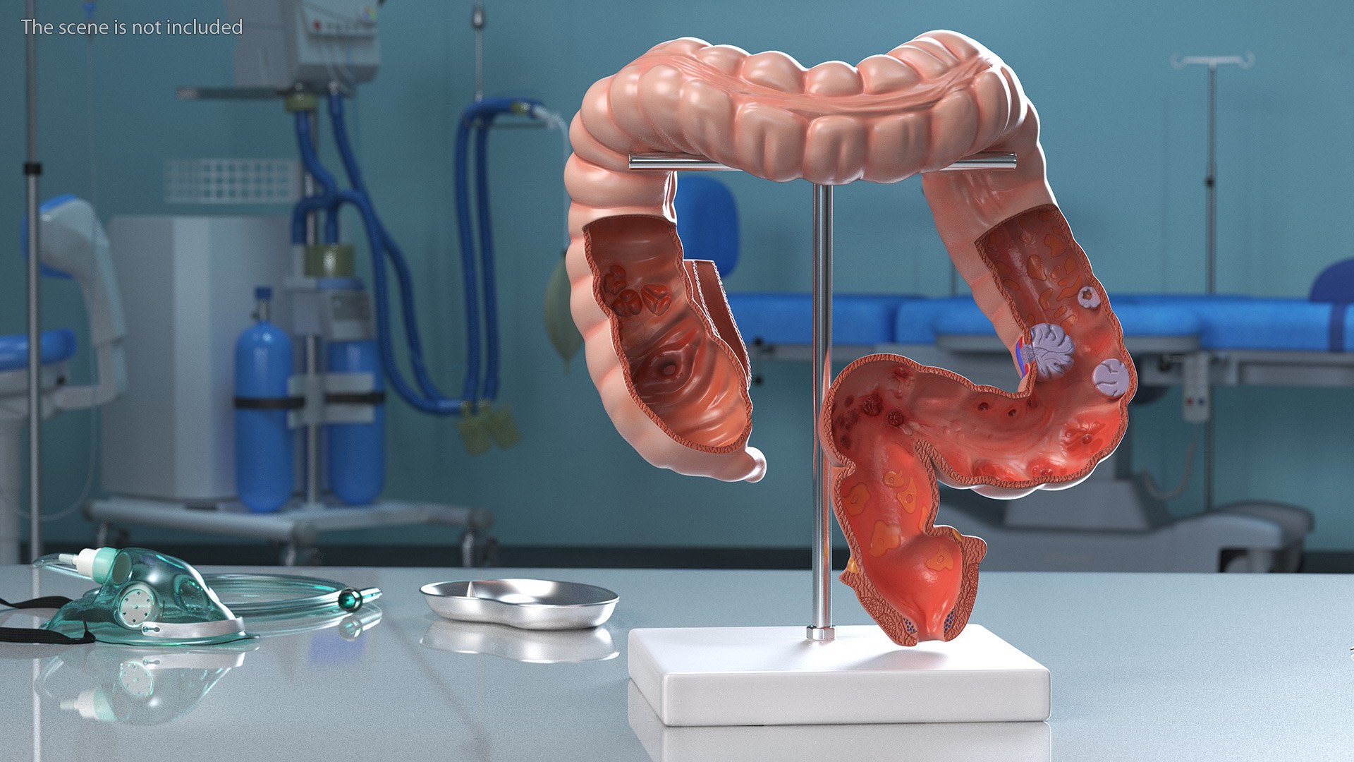 Medical Model Diseased Intestine Model - TurboSquid 2068464