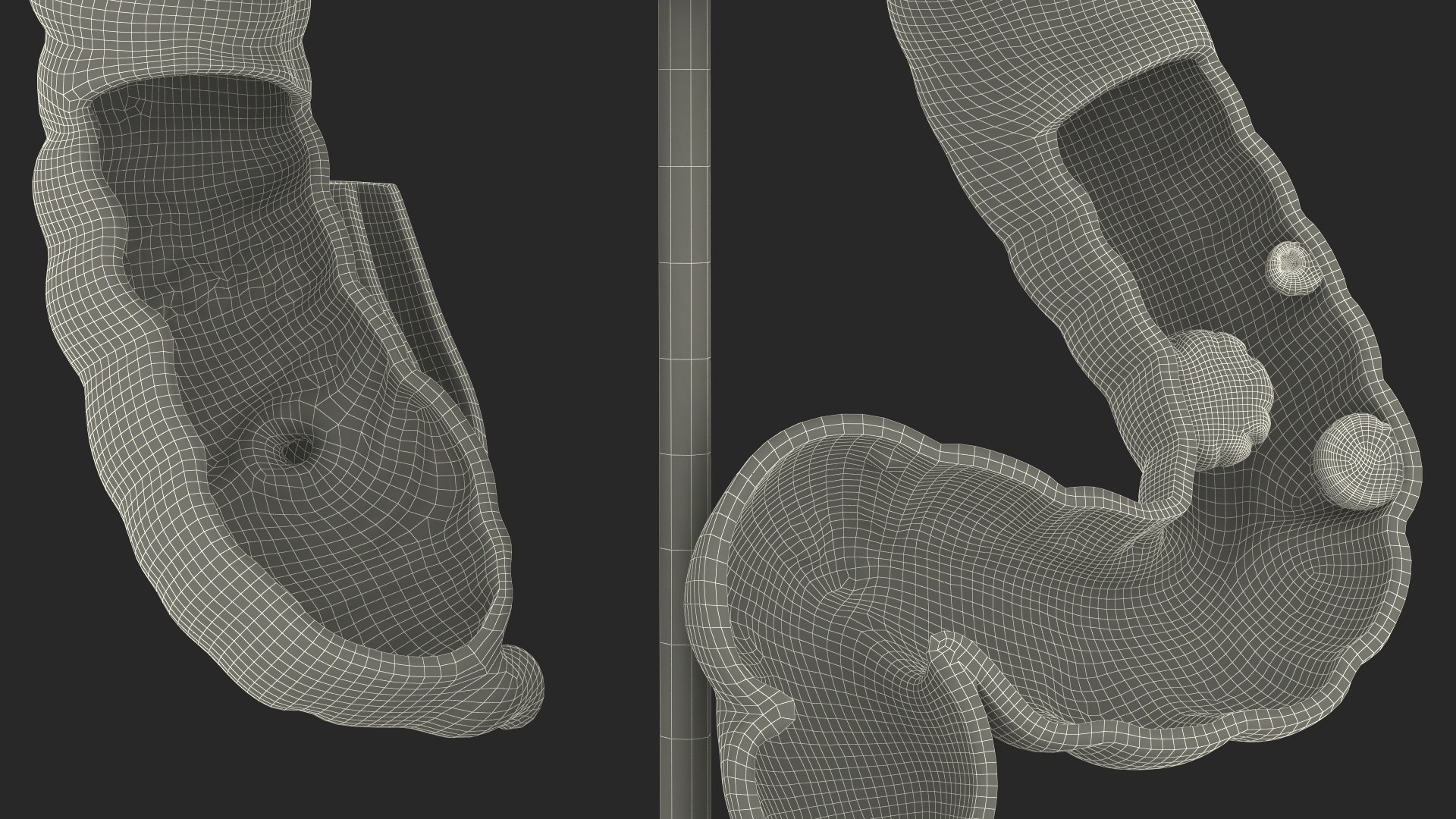 Medical Model Diseased Intestine Model - TurboSquid 2068464