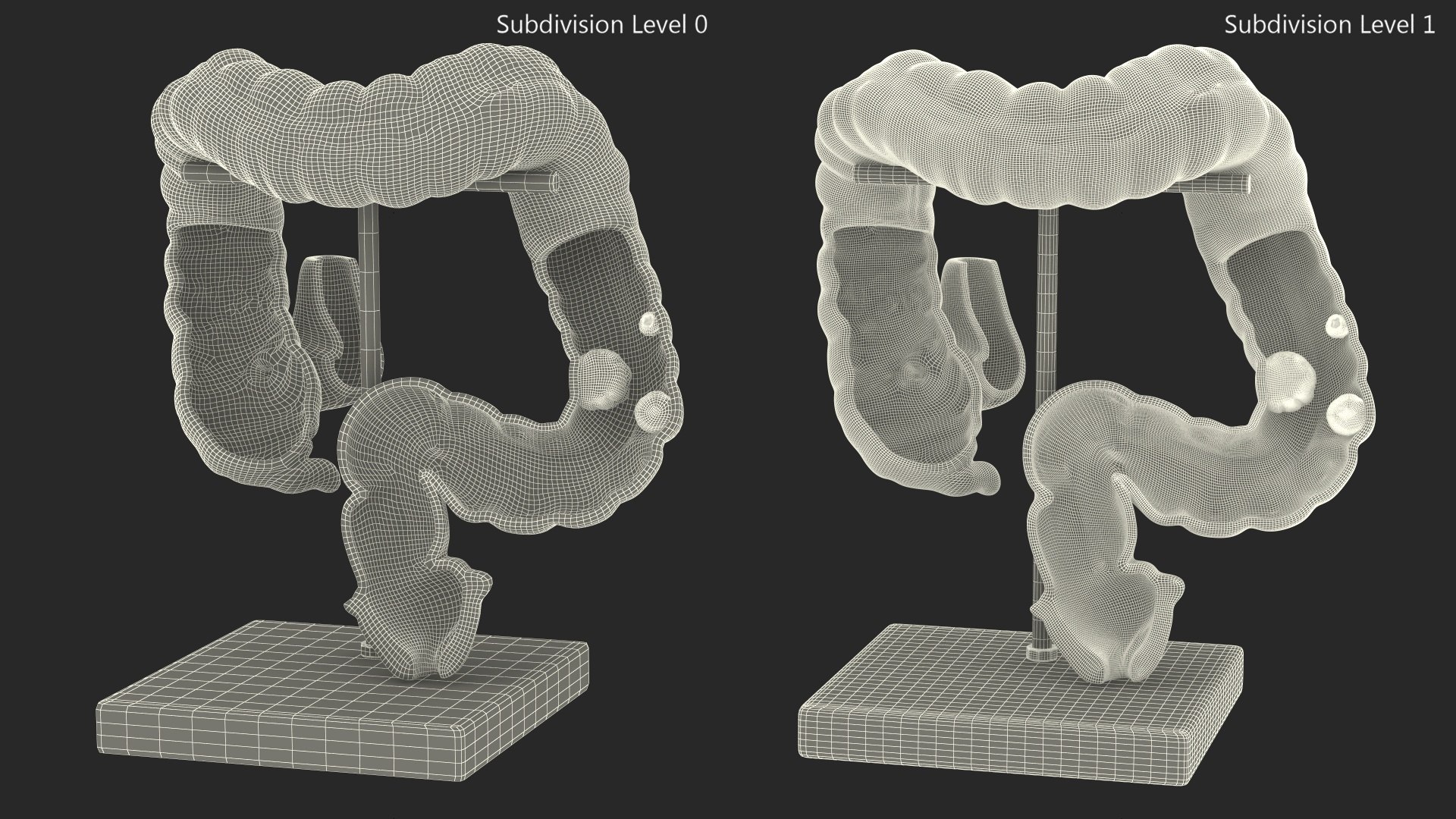 Medical Model Diseased Intestine Model - TurboSquid 2068464