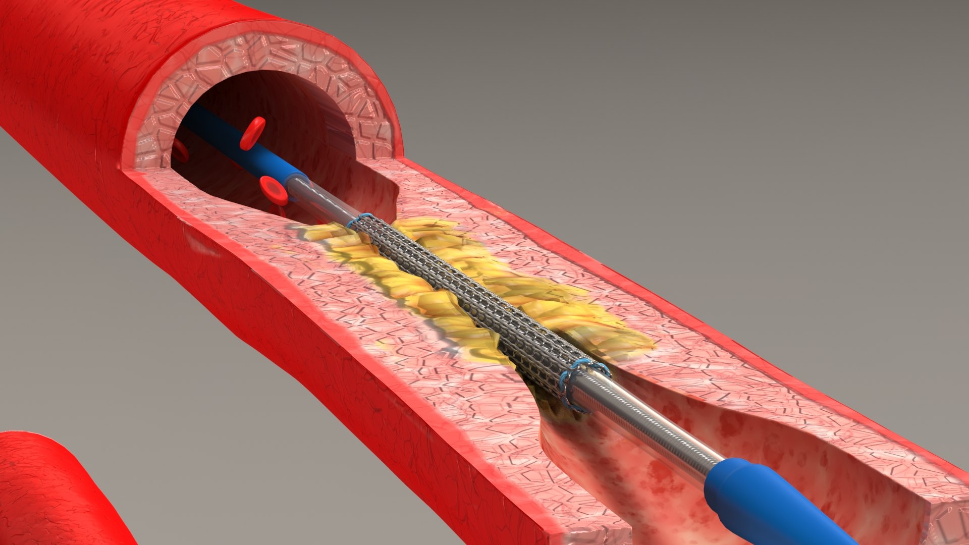 3D stents artery - TurboSquid 1647742
