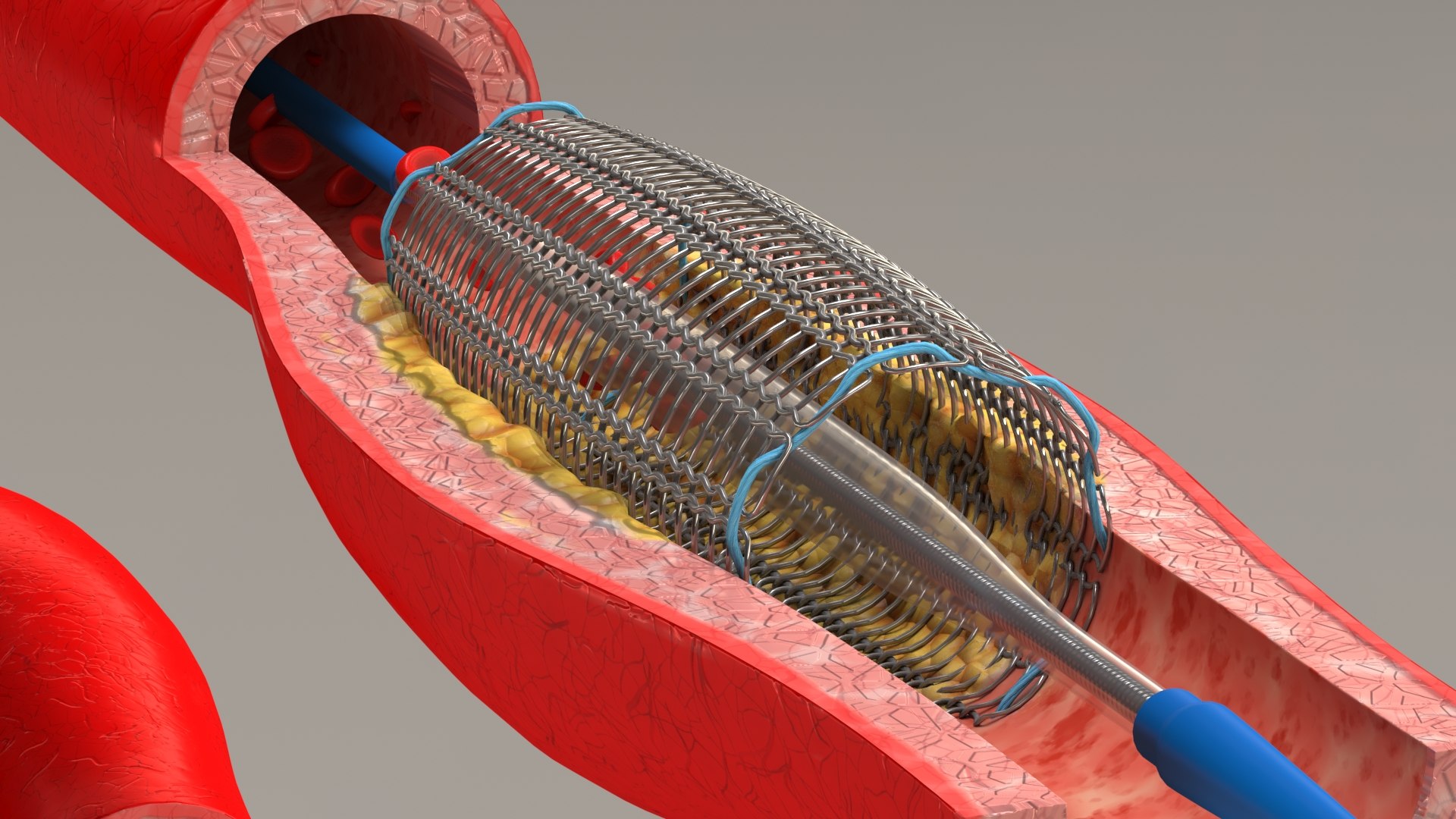 3D stents artery - TurboSquid 1647742