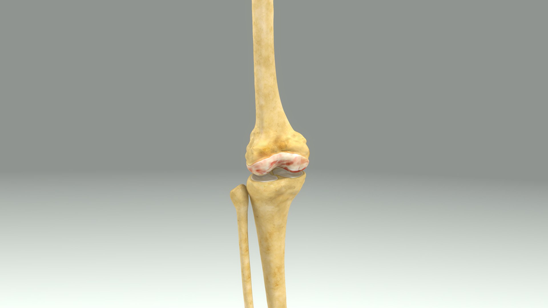 Damaged Knee Joint Obj
