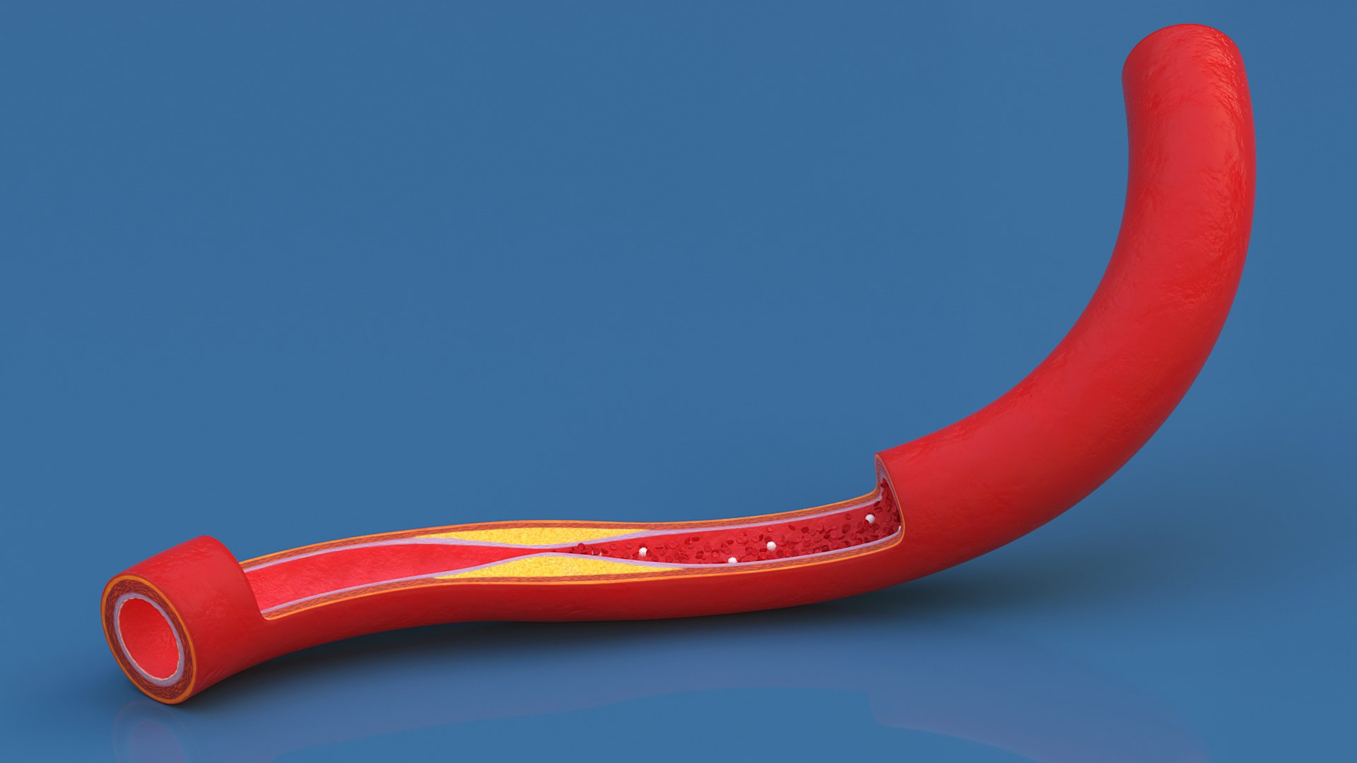 3D Cholesterol Blocked Artery In Cross Section Model - TurboSquid 2330141