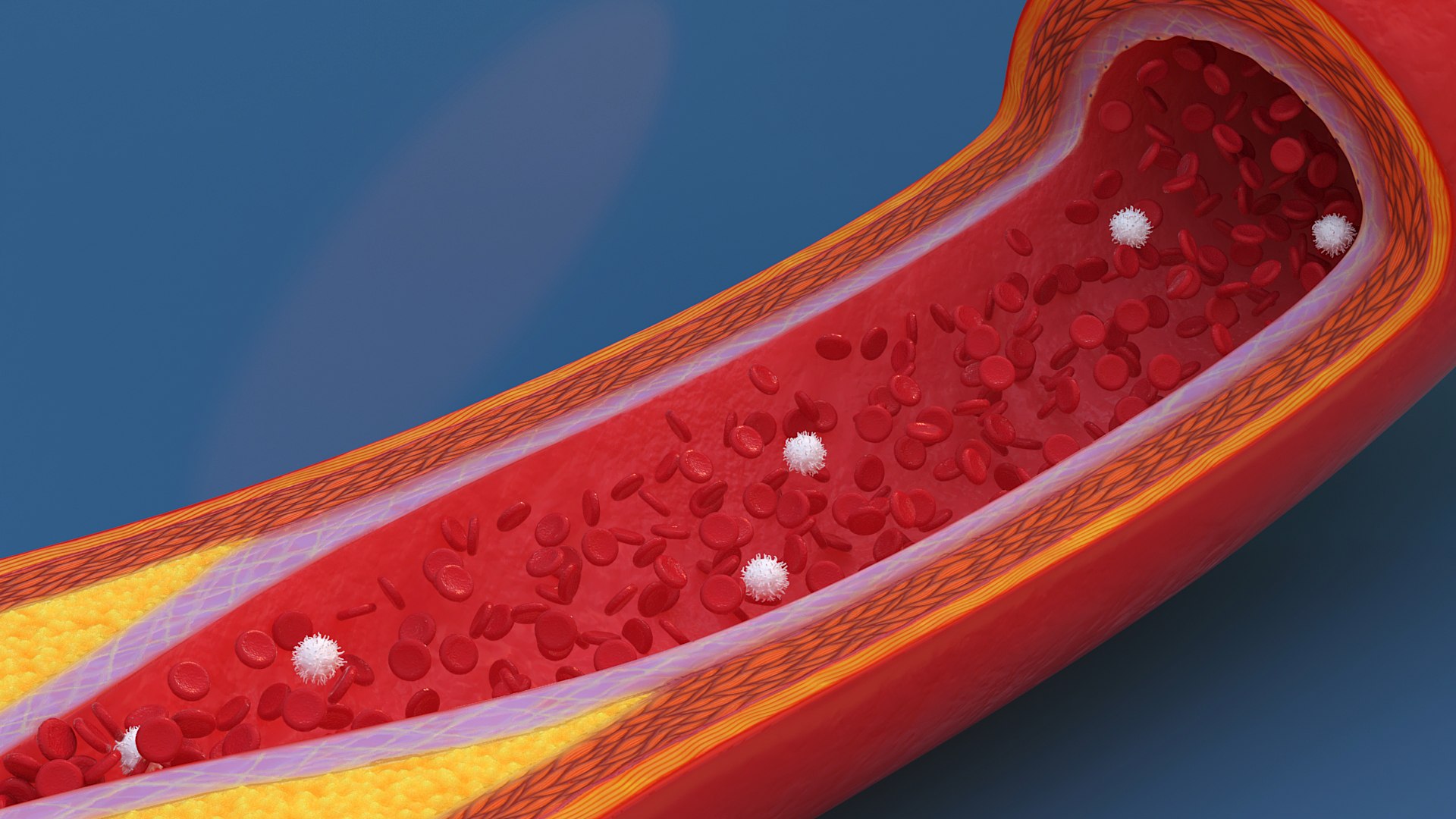 3D Cholesterol Blocked Artery In Cross Section Model - TurboSquid 2330141