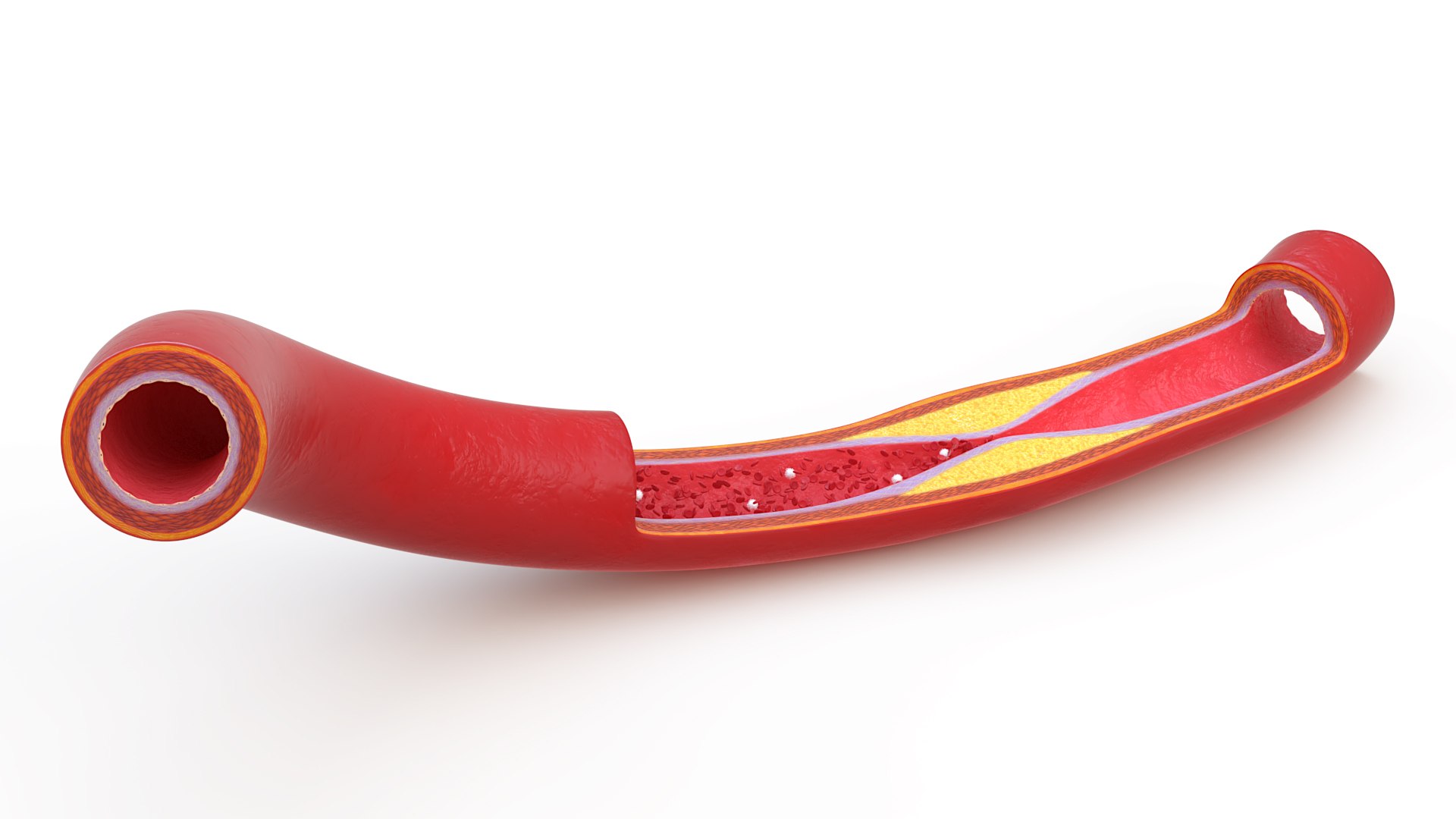 3D Cholesterol Blocked Artery In Cross Section Model - TurboSquid 2330141