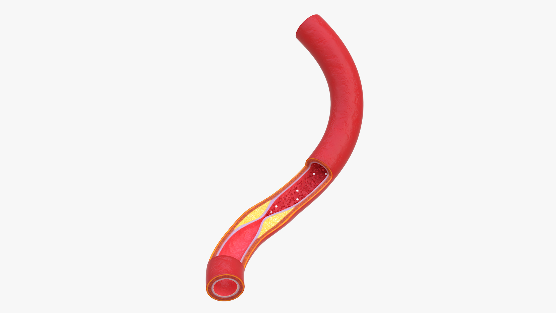 3D Cholesterol Blocked Artery In Cross Section Model - TurboSquid 2330141
