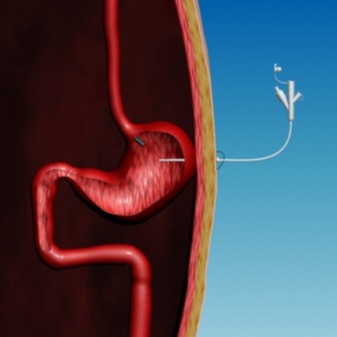3d Model Of Gastrostomy Stomach