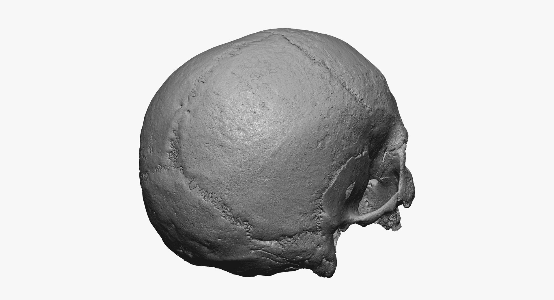 Human skull cranium leprosy 3D model - TurboSquid 1537164