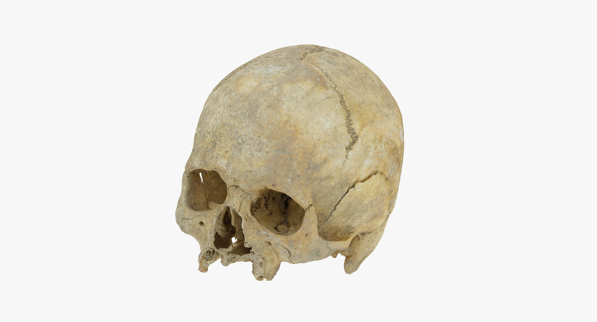 Human skull cranium leprosy 3D model - TurboSquid 1537164