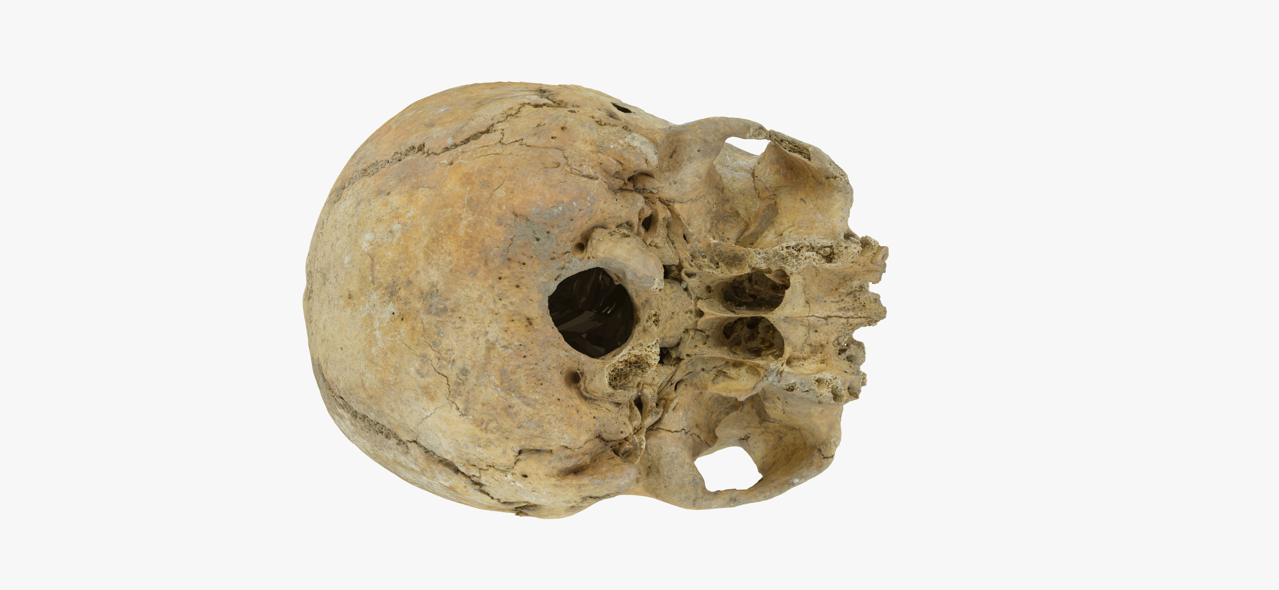 Human skull cranium leprosy 3D model - TurboSquid 1537164