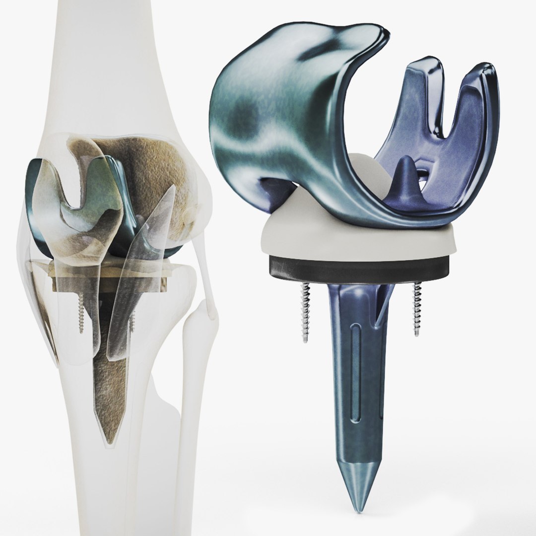 Replaced Knee Implant model - TurboSquid 2133197