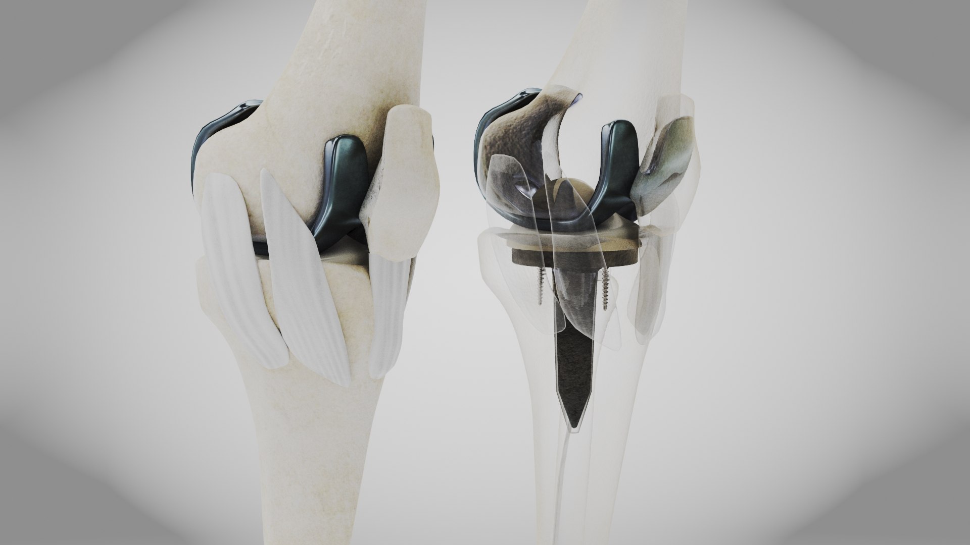 Replaced Knee Implant Model - TurboSquid 2133197