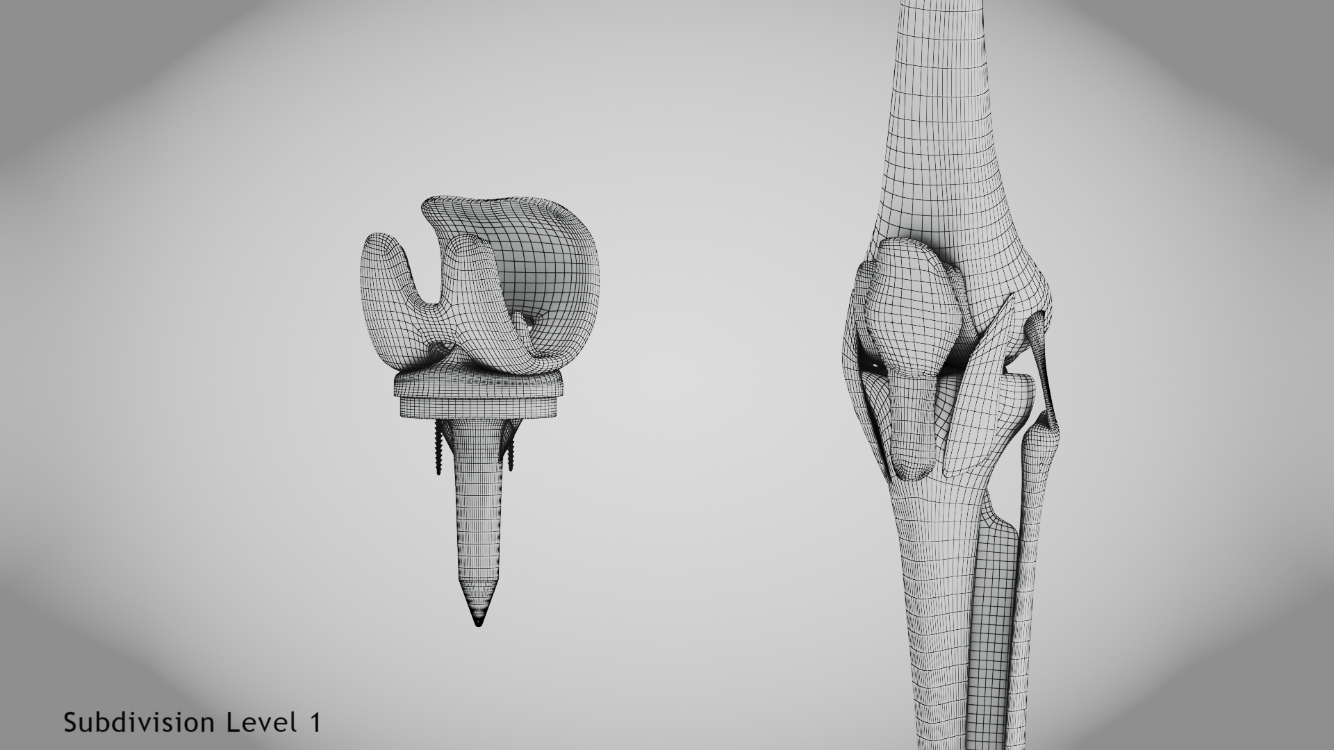 Replaced Knee Implant Model - TurboSquid 2133197