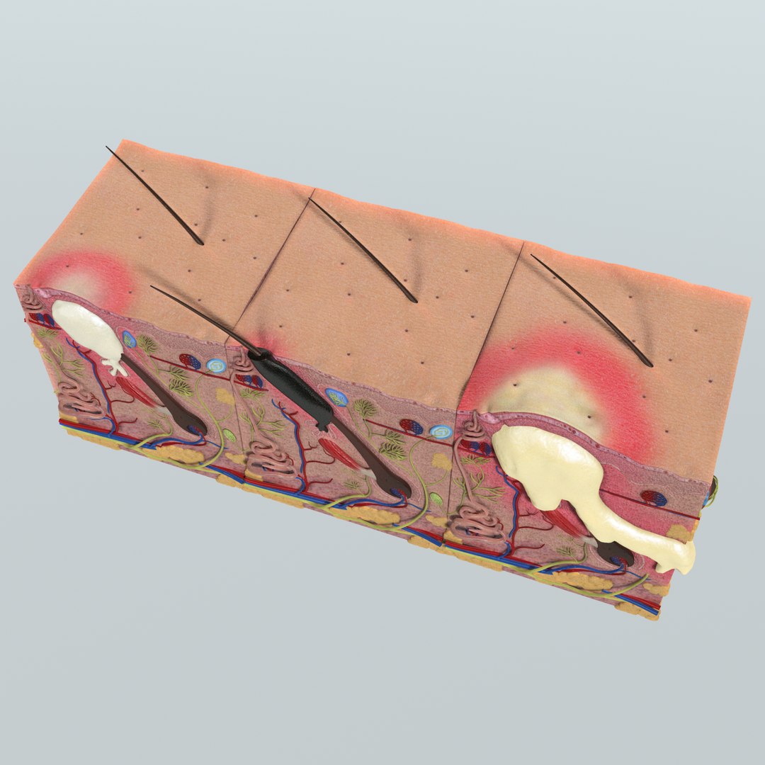 Realistic Skin Acne Anatomy 3D Model - TurboSquid 1164399