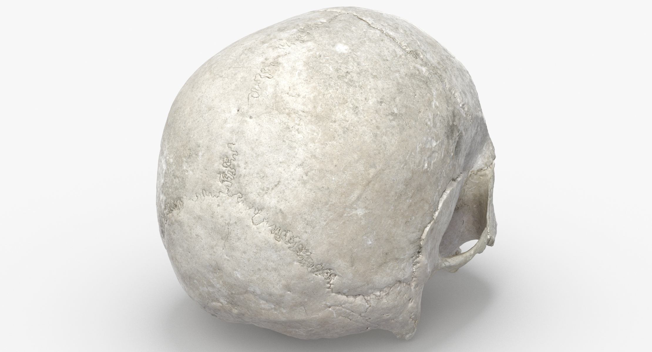 modelo 3d Cráneo humano real con lepra 01 Blanco1 - TurboSquid 1662437