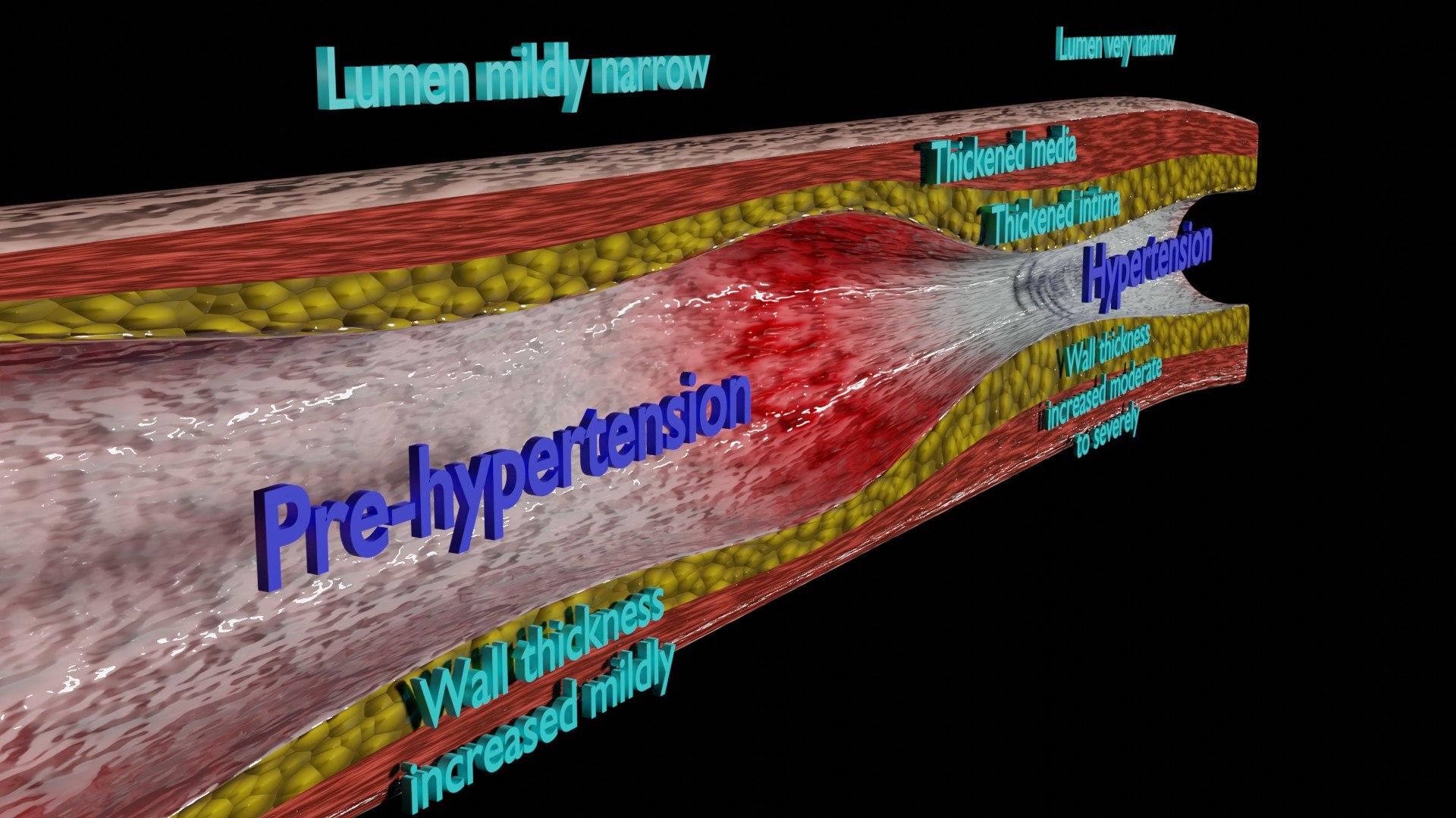 3D Hypertension Blood Vessel Artery Structural Change Model ...