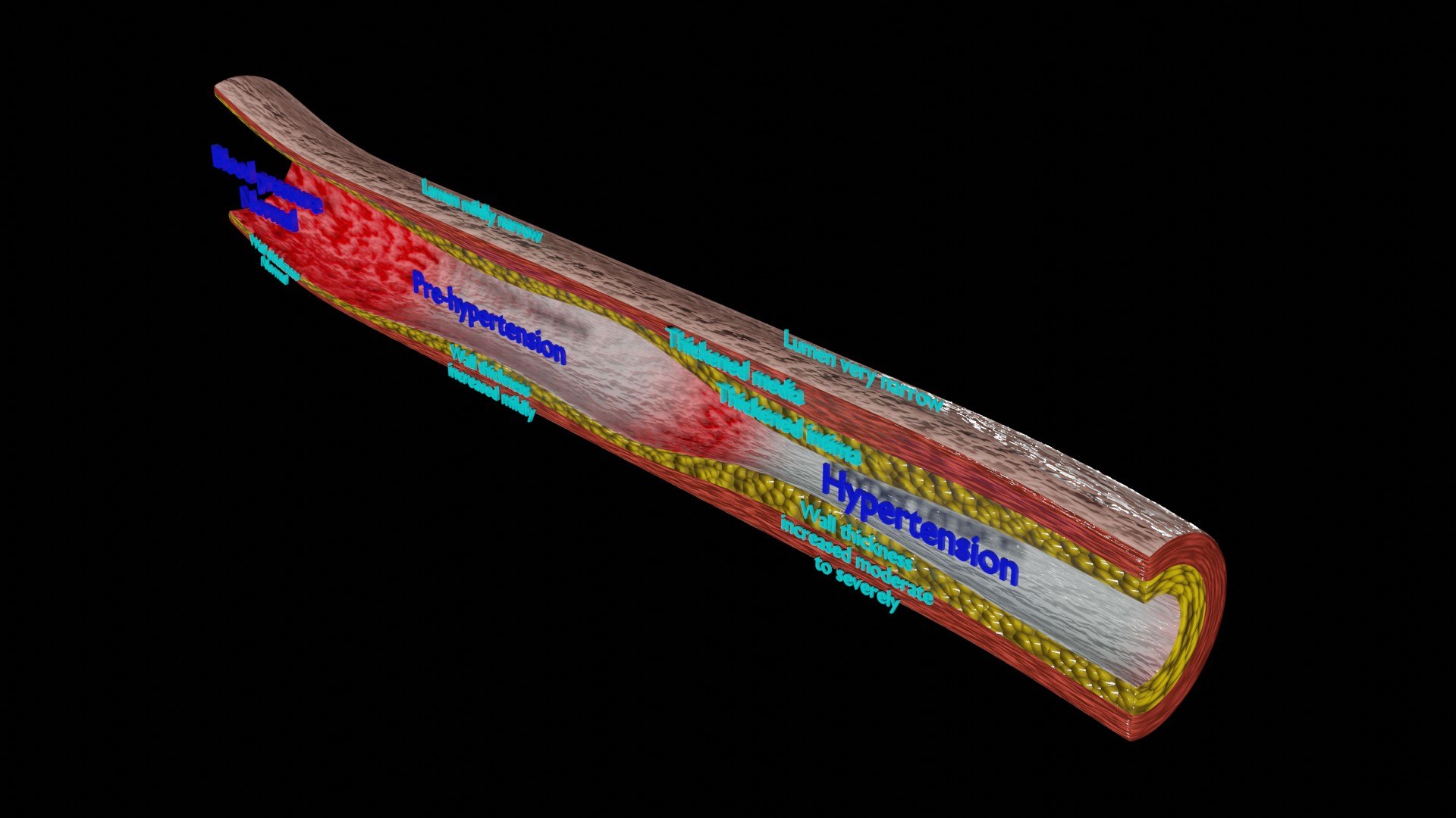 3D Hypertension Blood Vessel Artery Structural Change Model ...