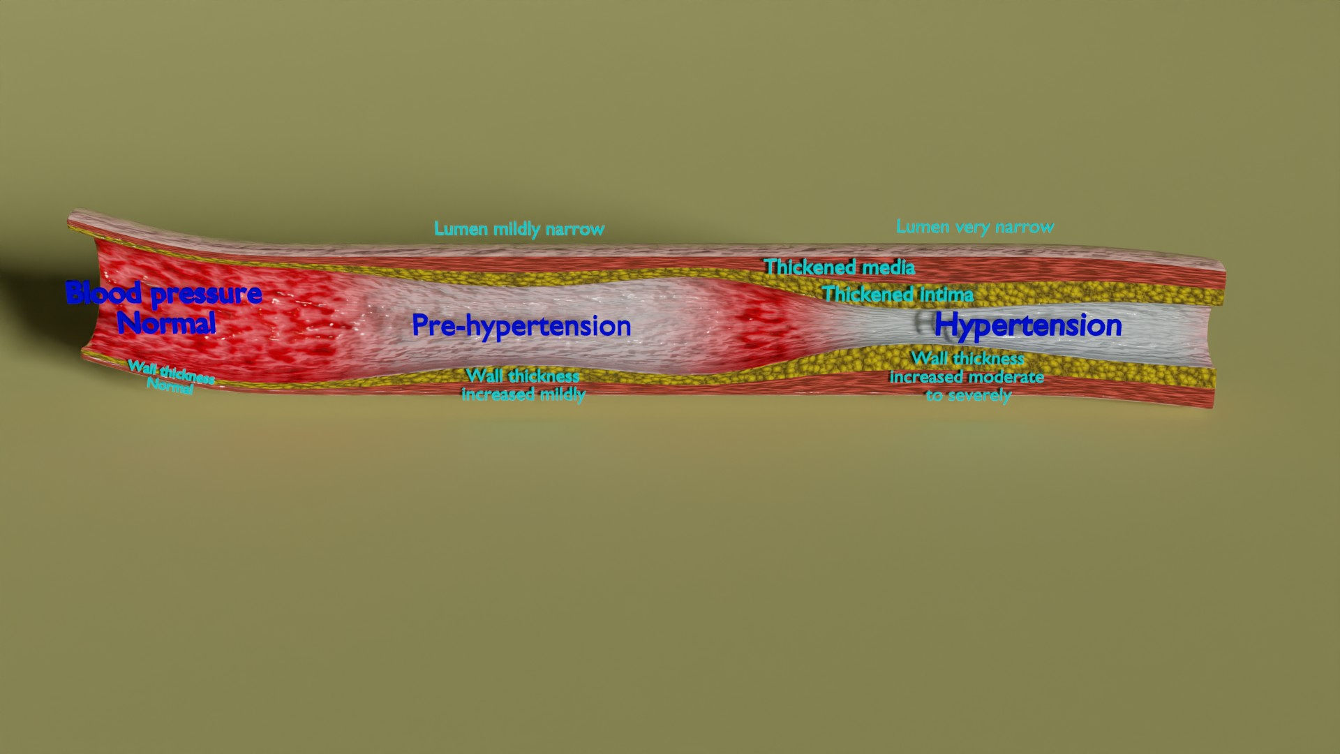 3D Hypertension Blood Vessel Artery Structural Change Model ...