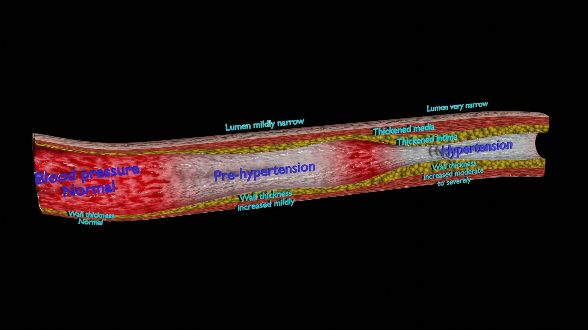 3D Hypertension Blood Vessel Artery Structural Change Model ...