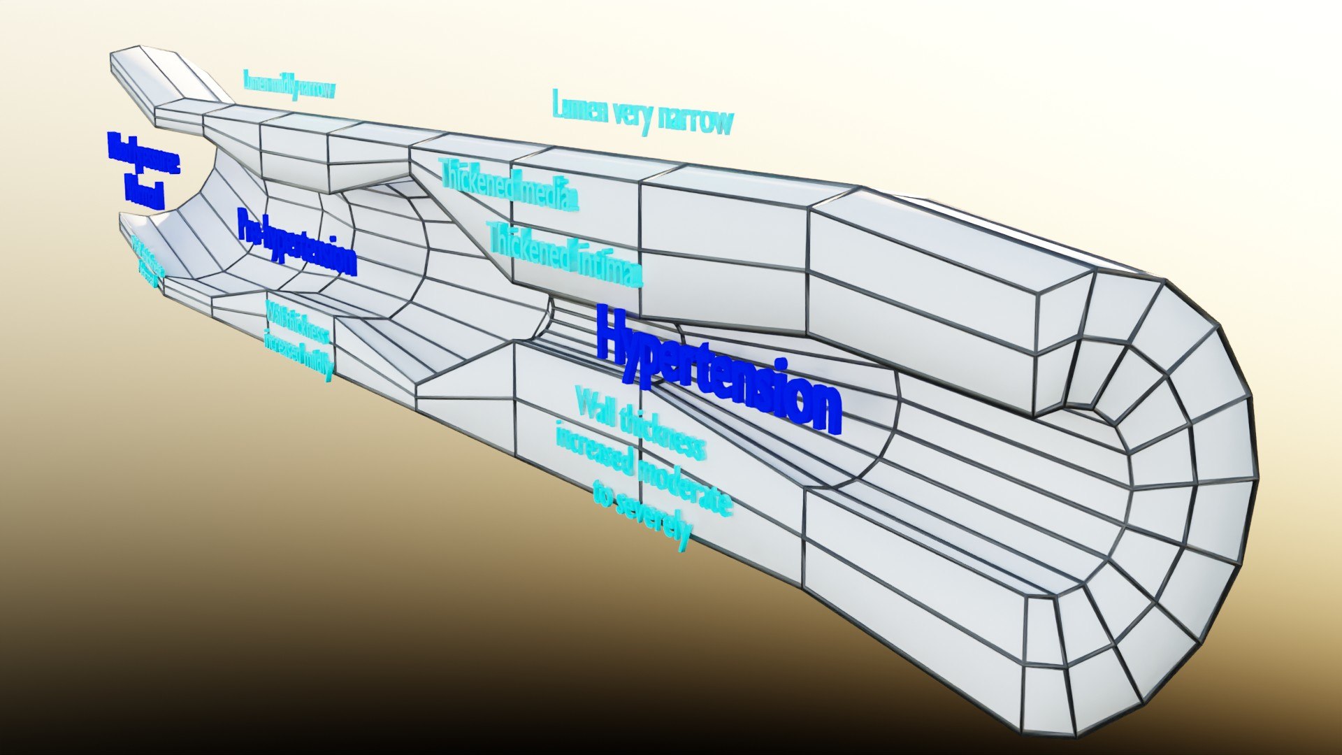 3D Hypertension Blood Vessel Artery Structural Change Model ...
