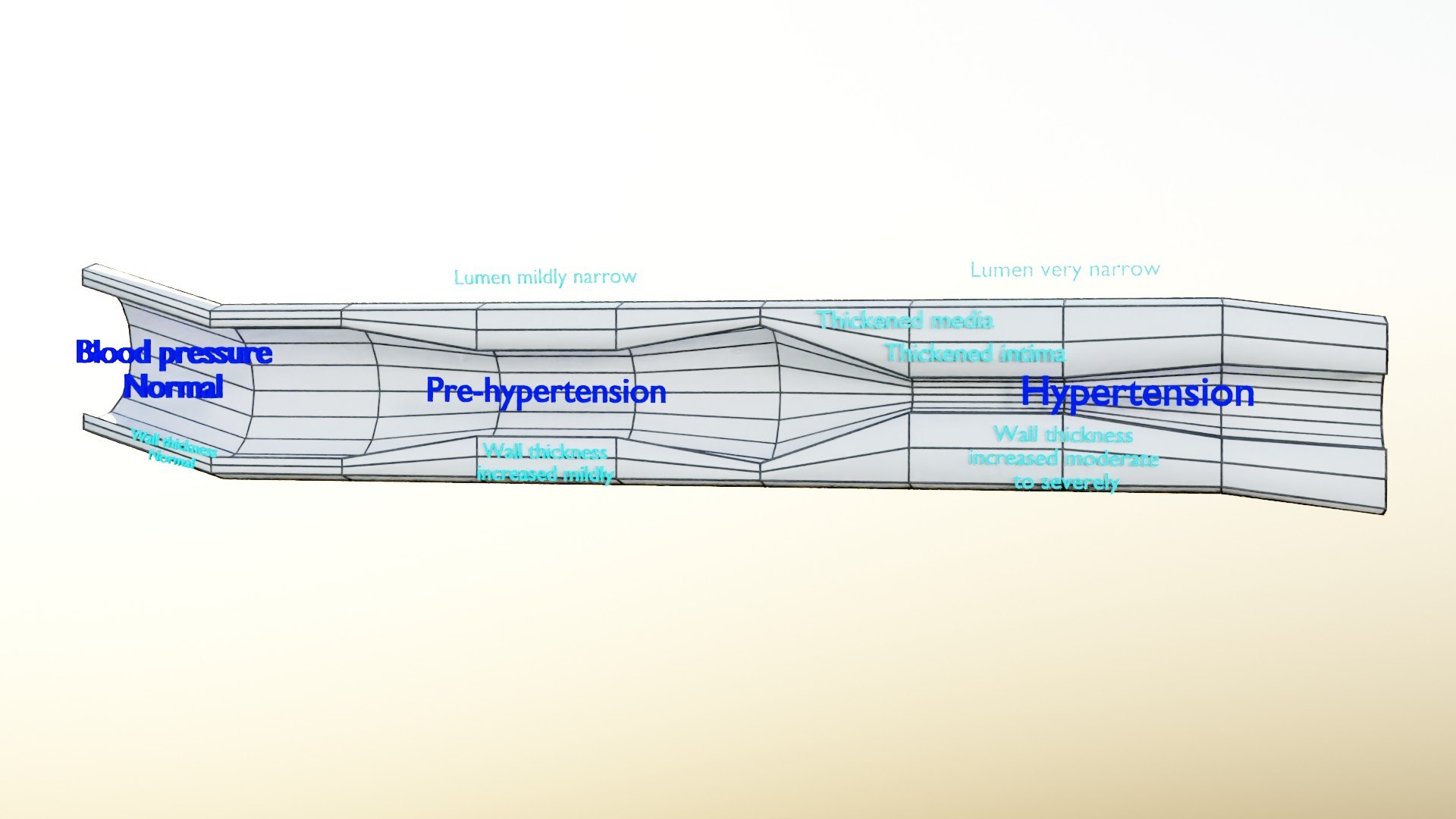 3D Hypertension Blood Vessel Artery Structural Change Model ...