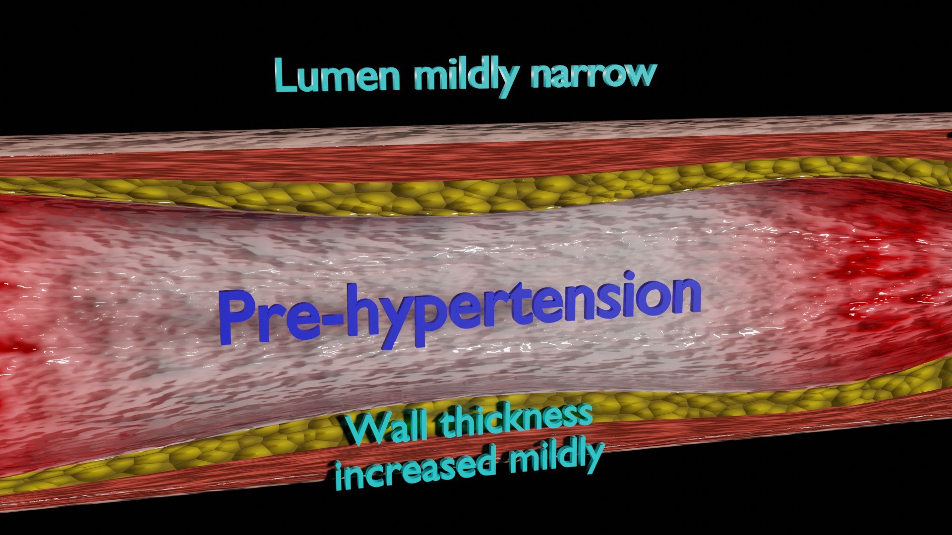 3D Hypertension Blood Vessel Artery Structural Change Model ...