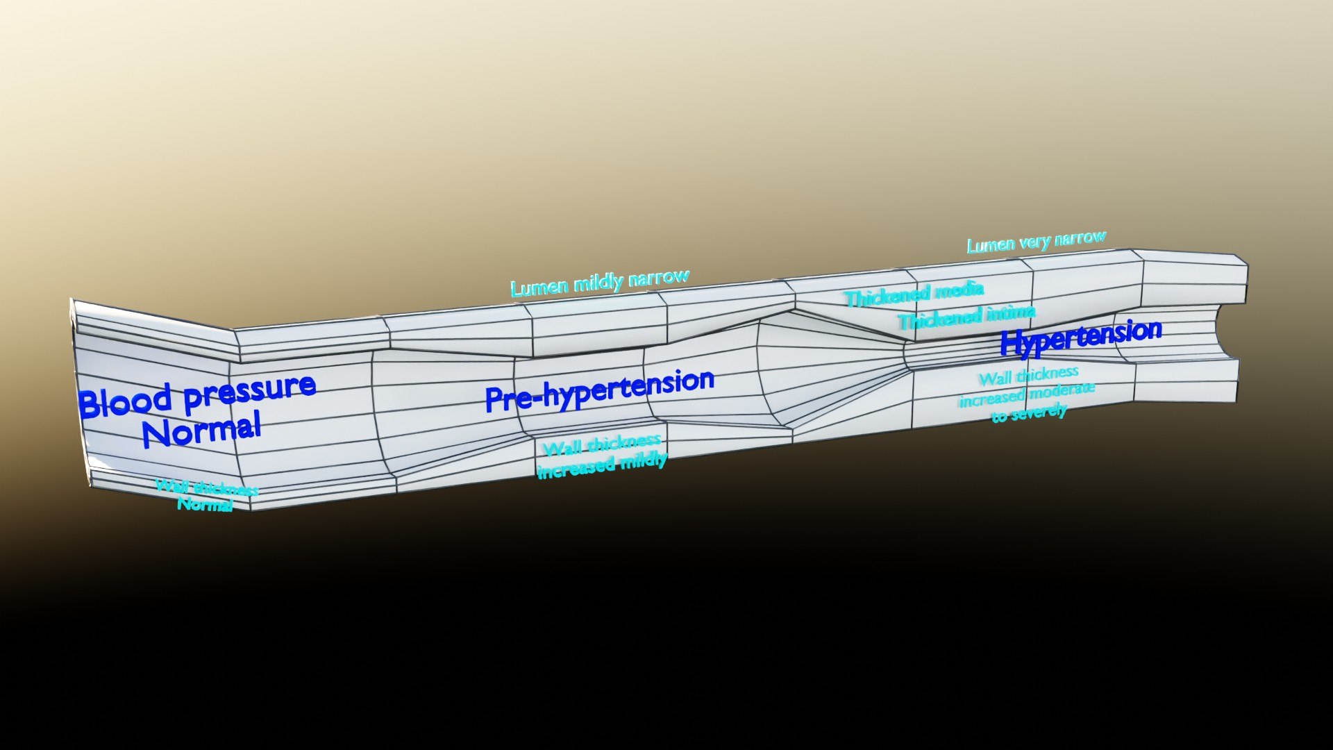 3D Hypertension Blood Vessel Artery Structural Change Model ...