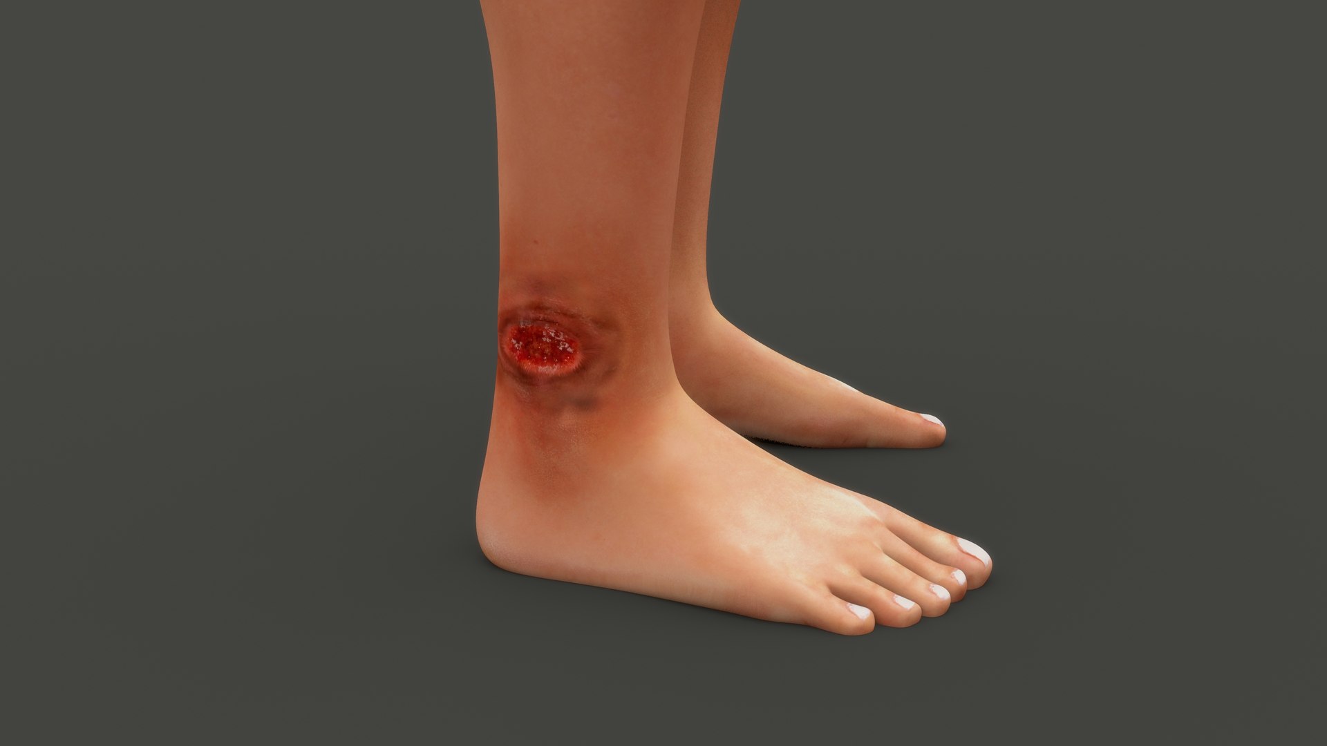 Leishmaniasis Disease Model - TurboSquid 1791593