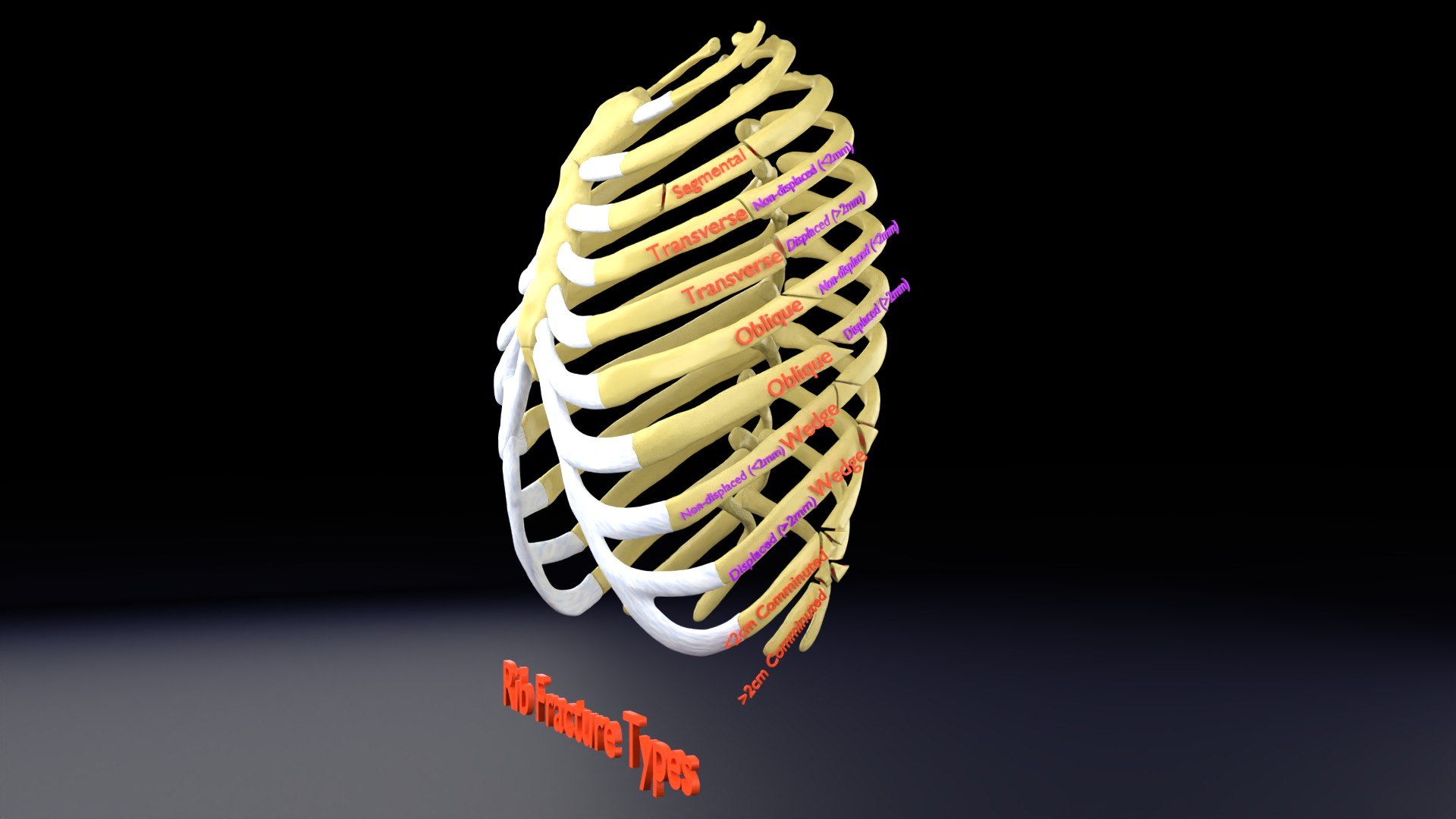 Rib Fracture And Its Types Model - TurboSquid 2278226
