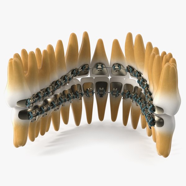 modelo 3d Brackets linguales en los dientes - TurboSquid 2335716