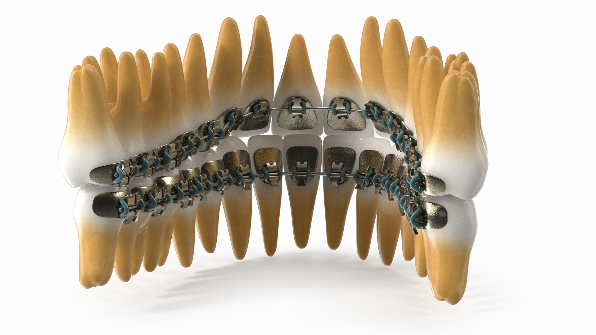 Lingual Braces On Teeth 3D Model - TurboSquid 2335716