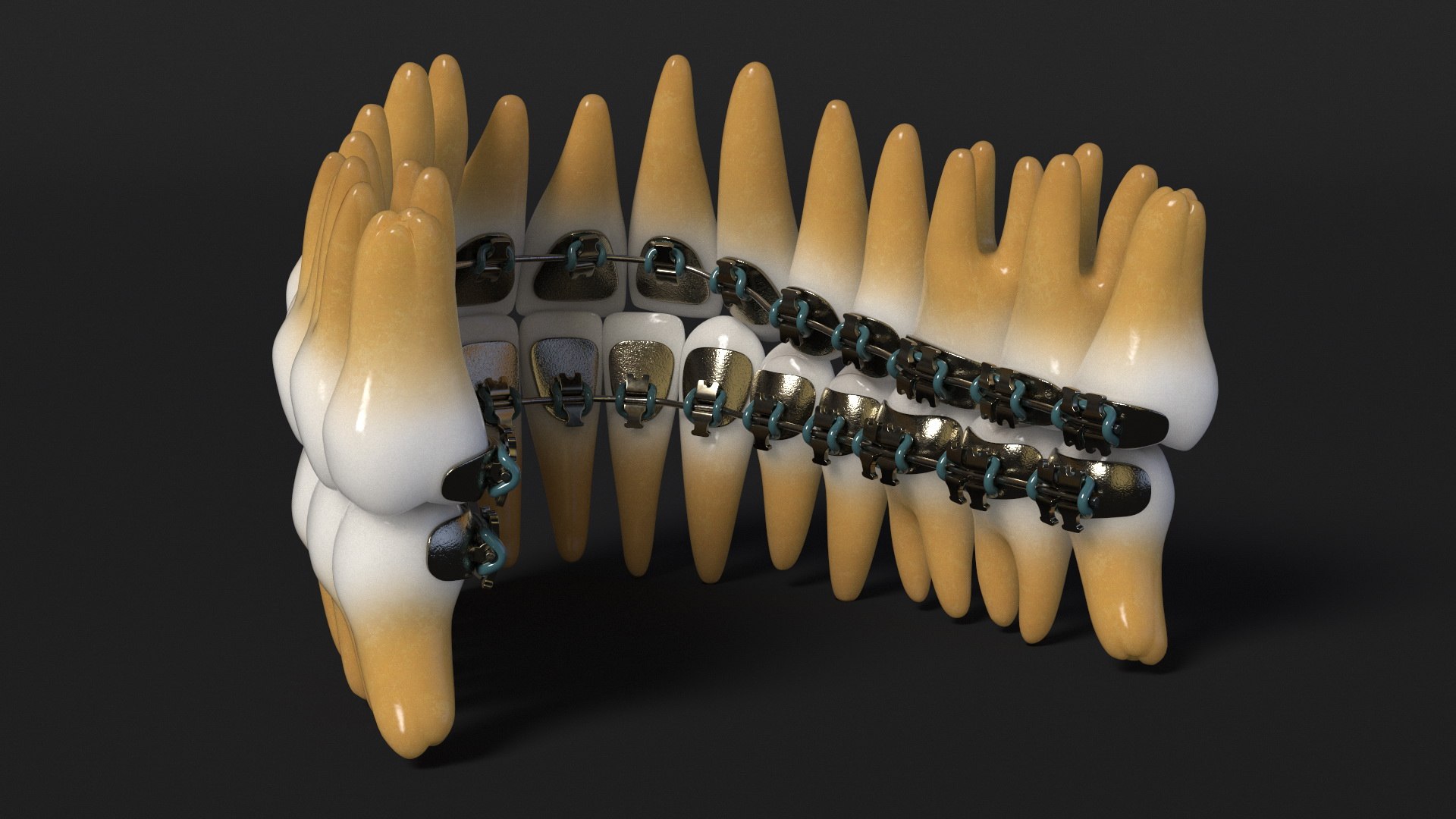 Lingual Braces On Teeth 3D Model - TurboSquid 2335716