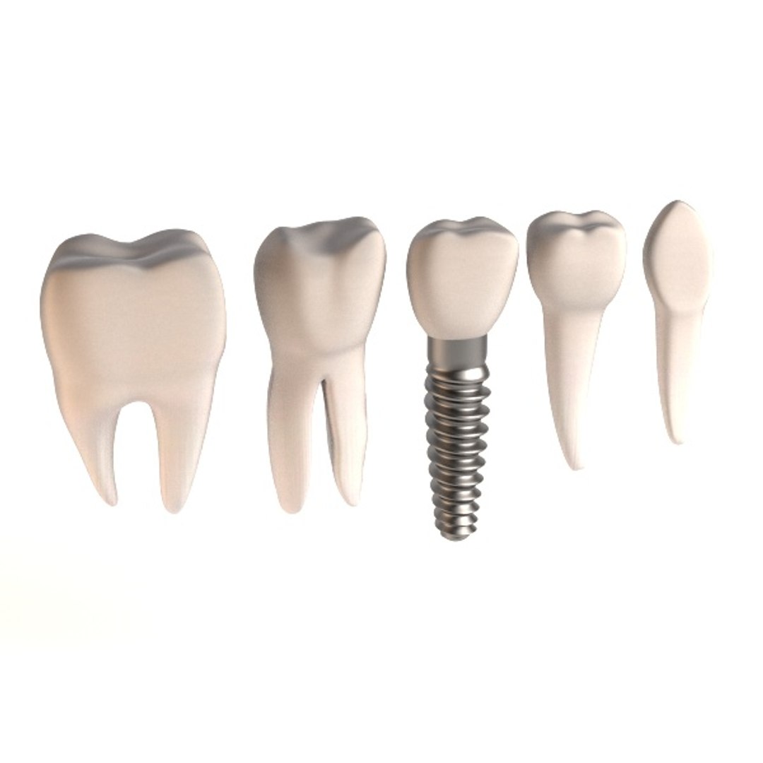 Dental Implant Teeth 3d Model