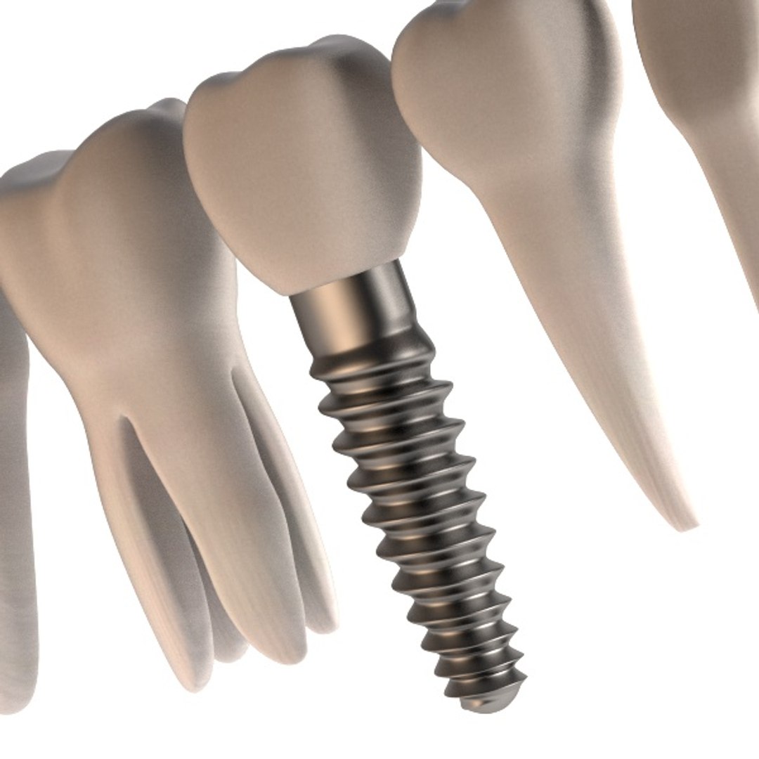 Dental Implant Teeth 3d Model