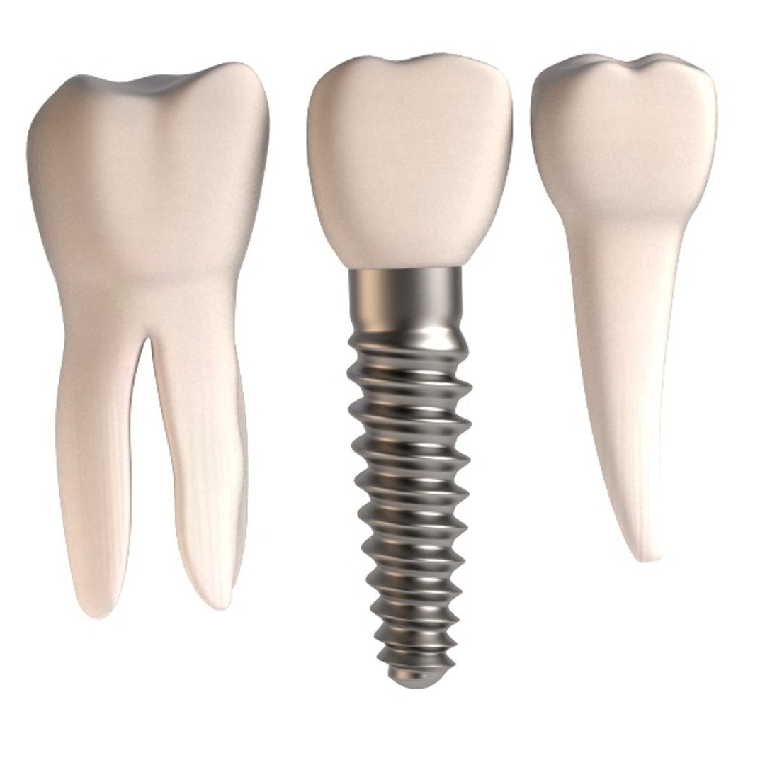 Dental Implant Teeth 3d Model