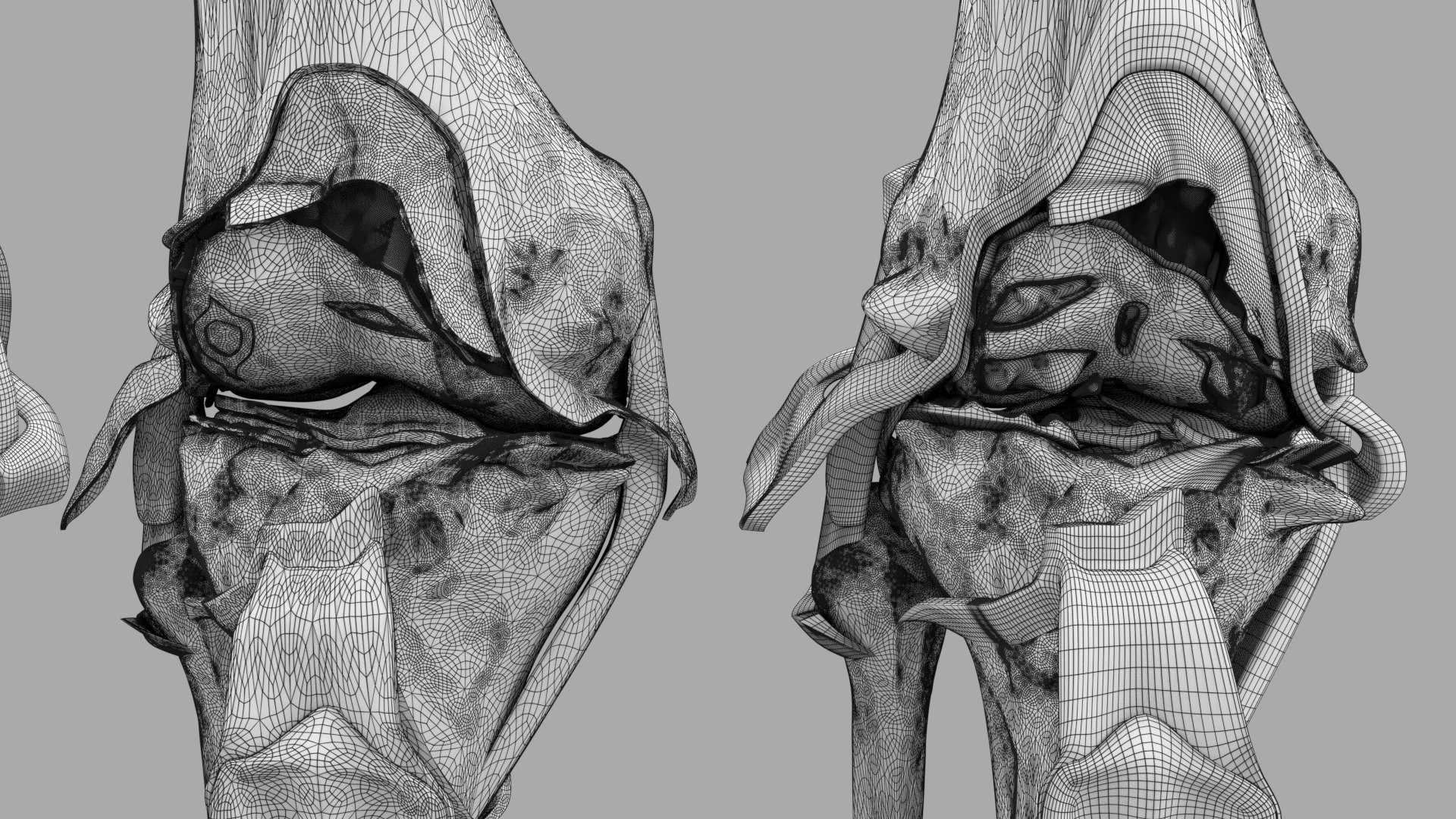 Osteoarthritis stages 3D - TurboSquid 1663612
