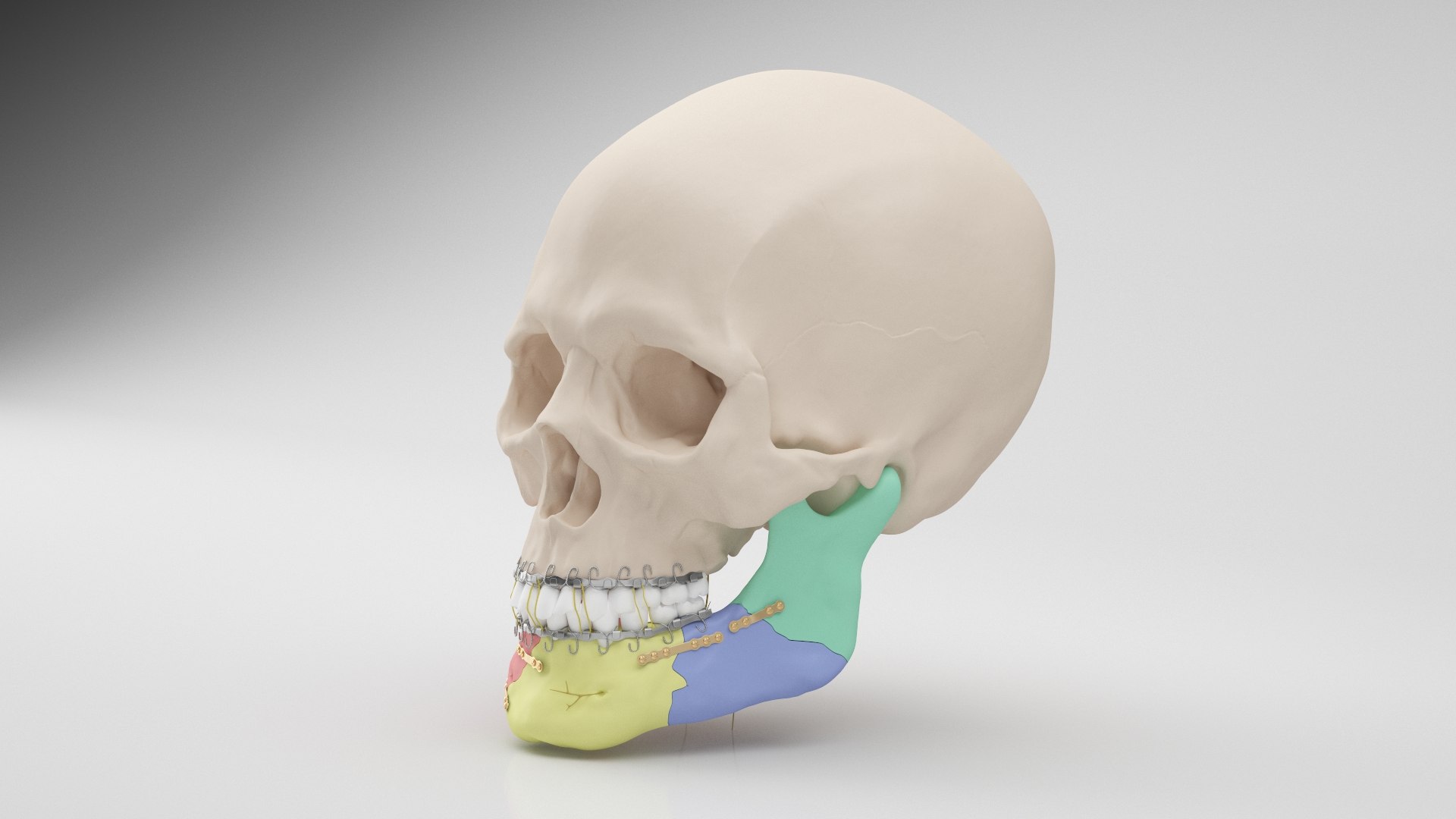 Male Skull - Mandible Fracture 3D Model - TurboSquid 2283852