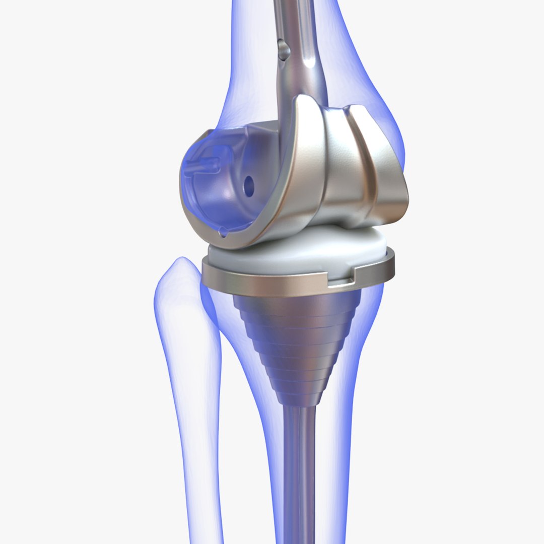 3D Knee Replacement Implant - TurboSquid 1994902