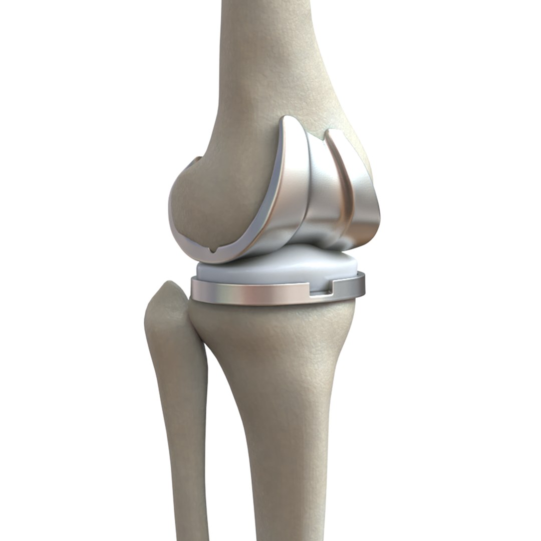 3D Knee Replacement Implant - TurboSquid 1994902