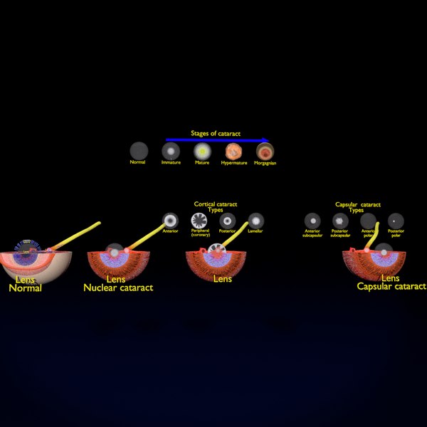 3D Cataract Models | TurboSquid