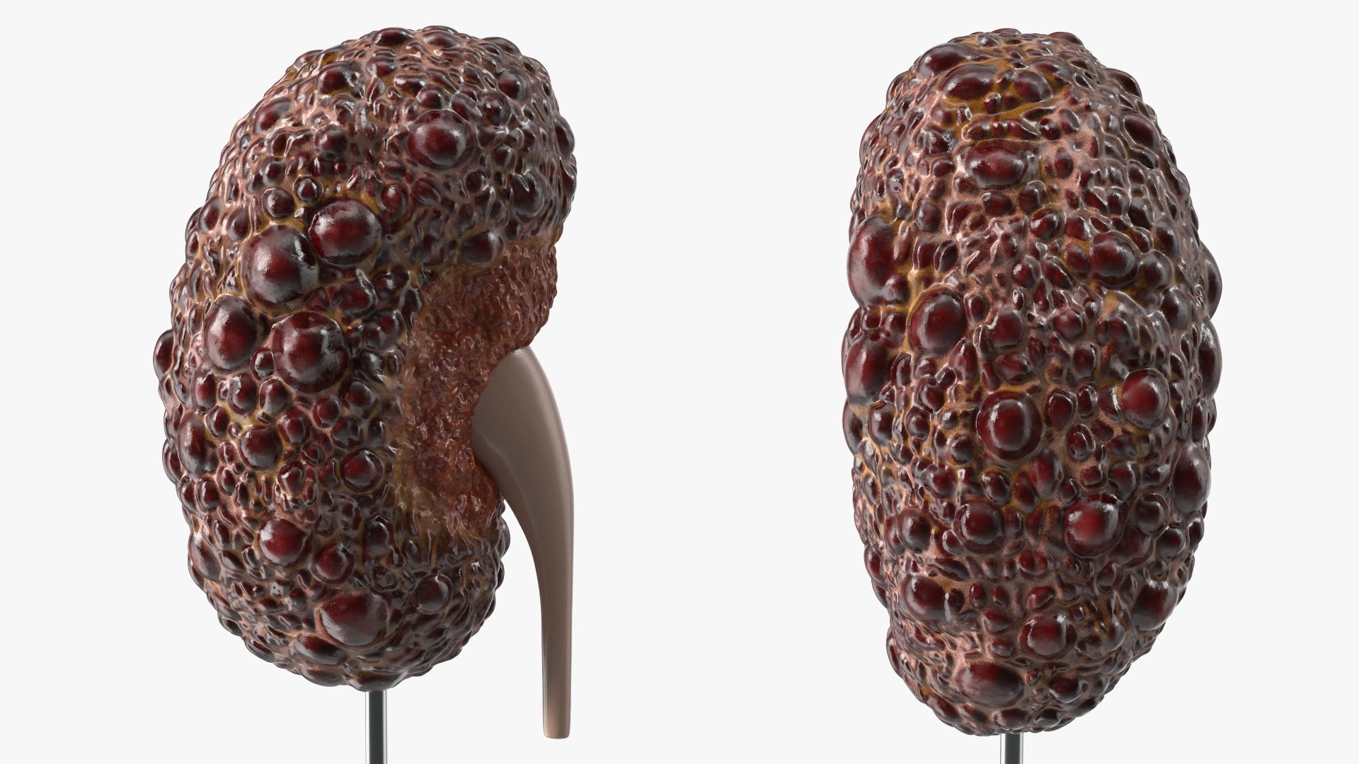 3D Polycystic Kidney Disease Model On Stand - TurboSquid 2411099