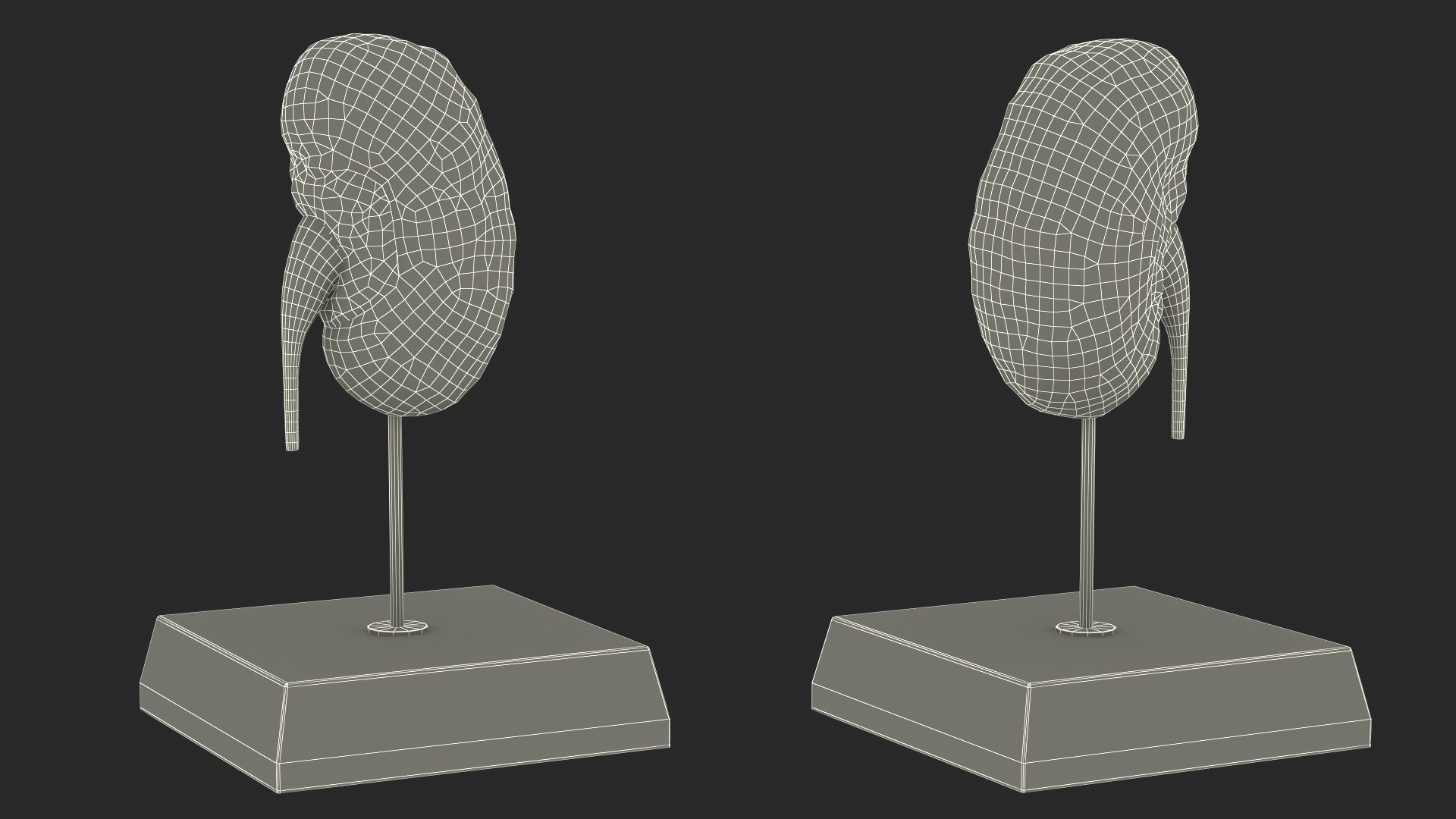 3D Polycystic Kidney Disease Model On Stand - TurboSquid 2411099