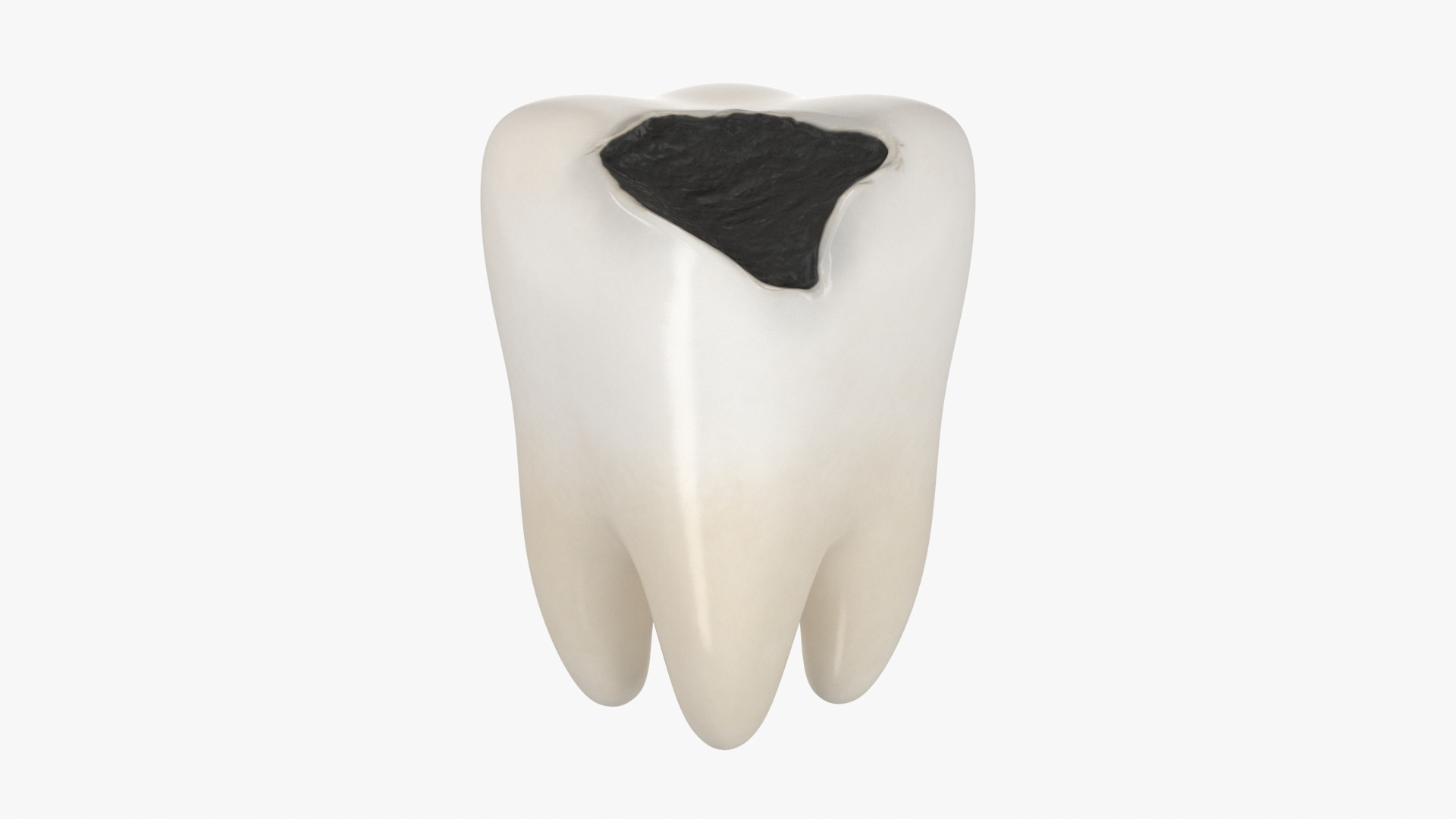 Teeth Decay 3D Model - TurboSquid 1438129
