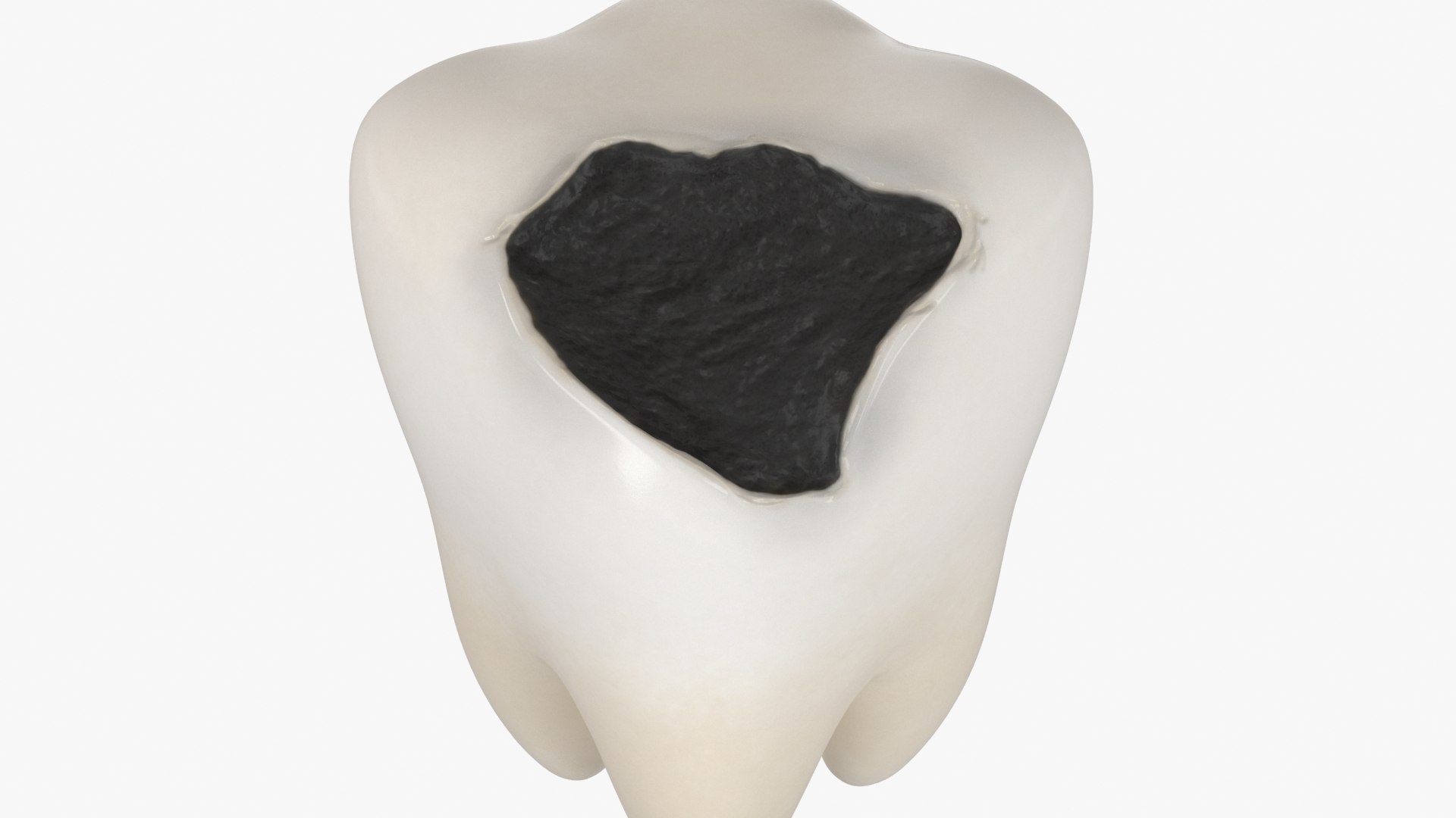 Teeth Decay 3D Model - TurboSquid 1438129