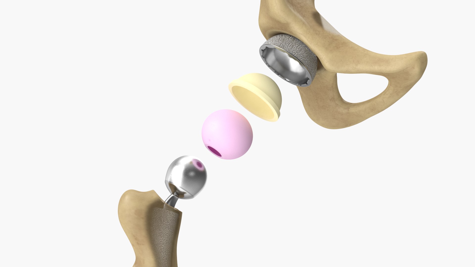 Hip Bone Replacement Surgery V02 3D Model - TurboSquid 1744809